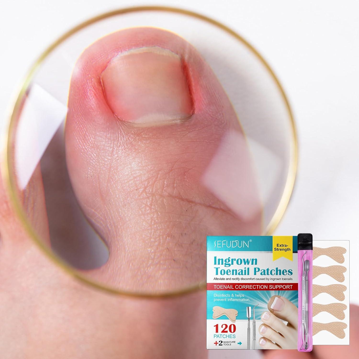 Ingrown Toenail Patch Ingrown Toenail Corrector | Toenail Repair to ...