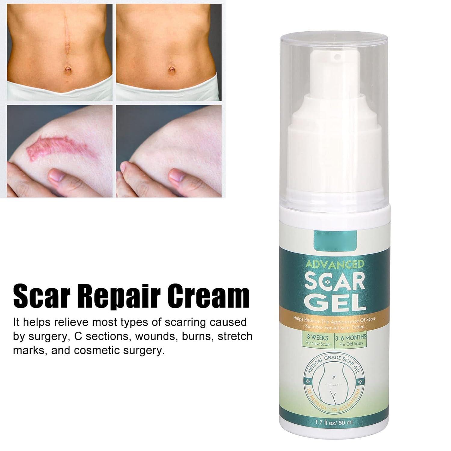 50ml Scar Removal Cream for Old & New Scars - Stretch Marks, Burn ...