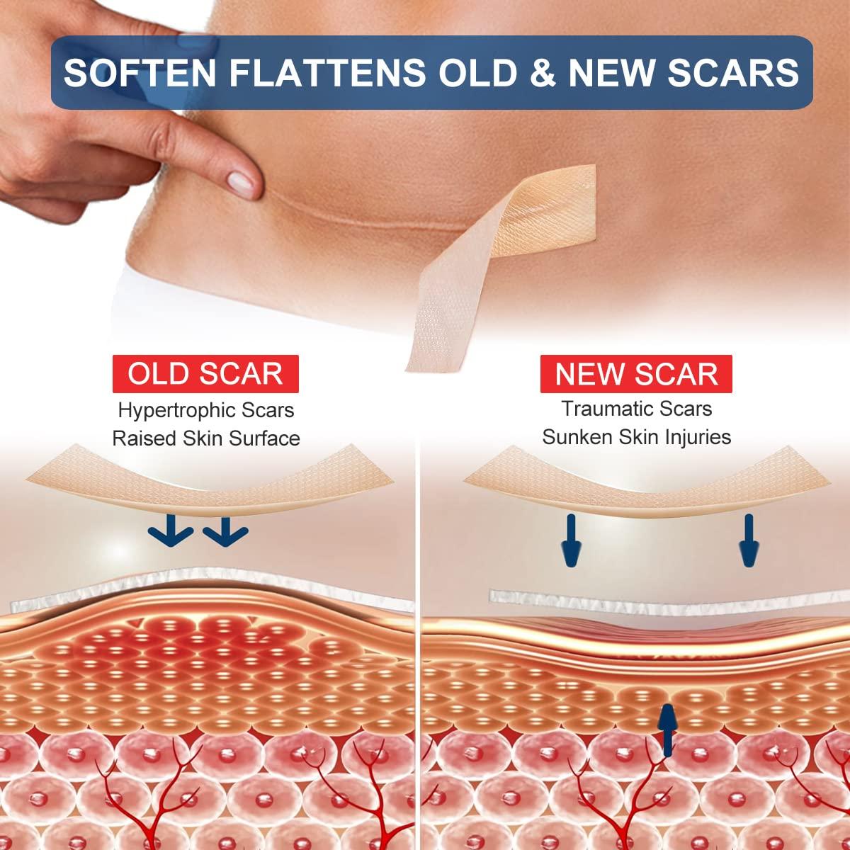 Scar Away Silicone Scar Sheets - Professional Scar Tape for Surgery ...