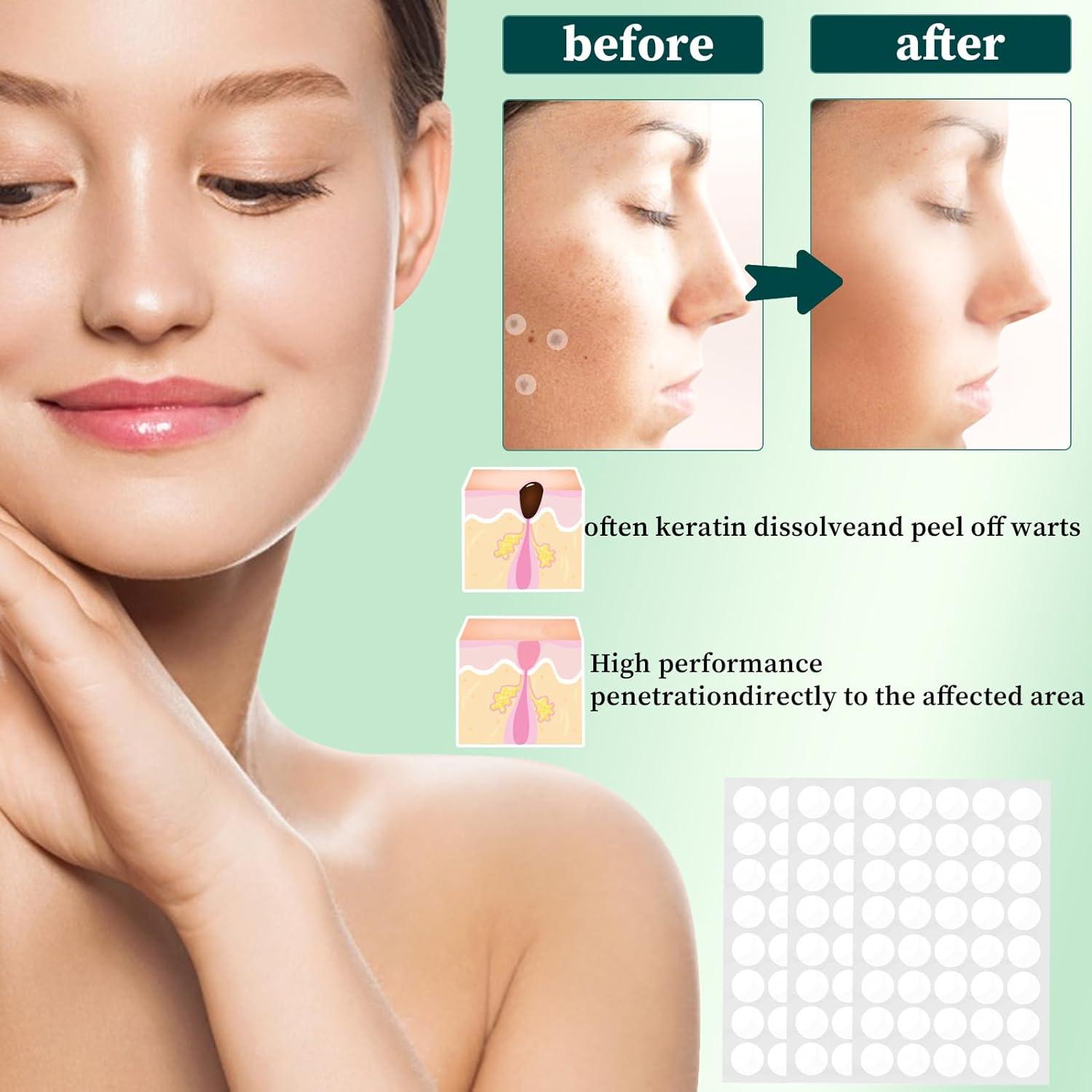 Skin Tag & Mole Removal Patches - 120 PCS Wart Treatment Stickers | Buy ...