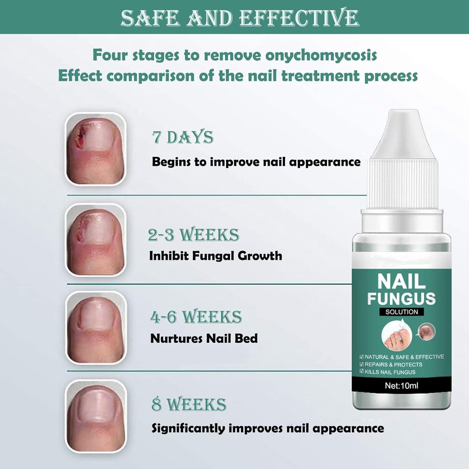 Fungal Nail Treatment for Toenail Extra Strong Safety Effective Nail ...