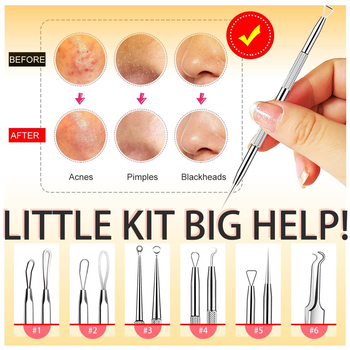 6-Piece Blackhead Remover Tool Kit with Case - Professional Acne ...