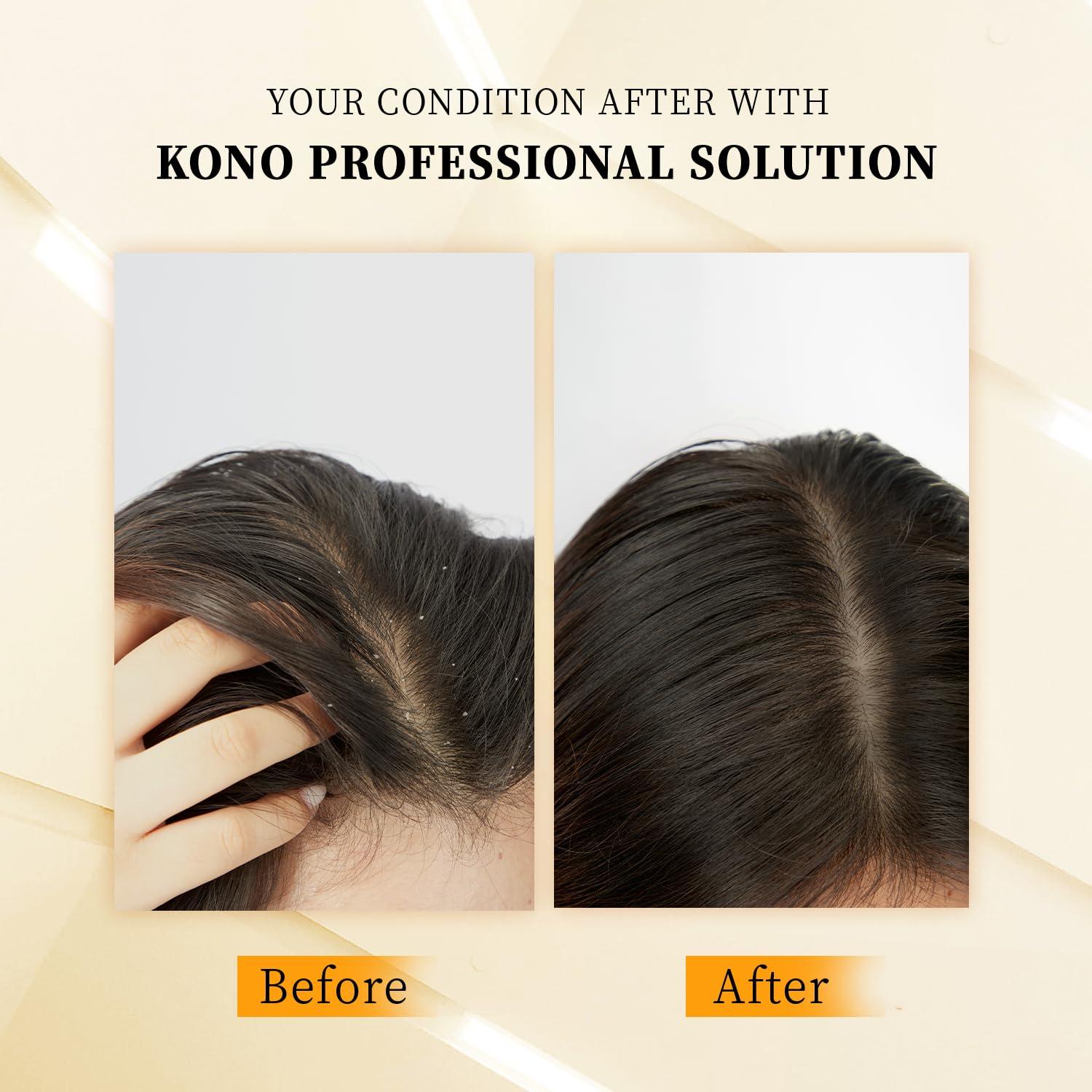 KONO Anti-Dandruff Shampoo - Luxury Series 16.9 OZ | Effective Relief ...