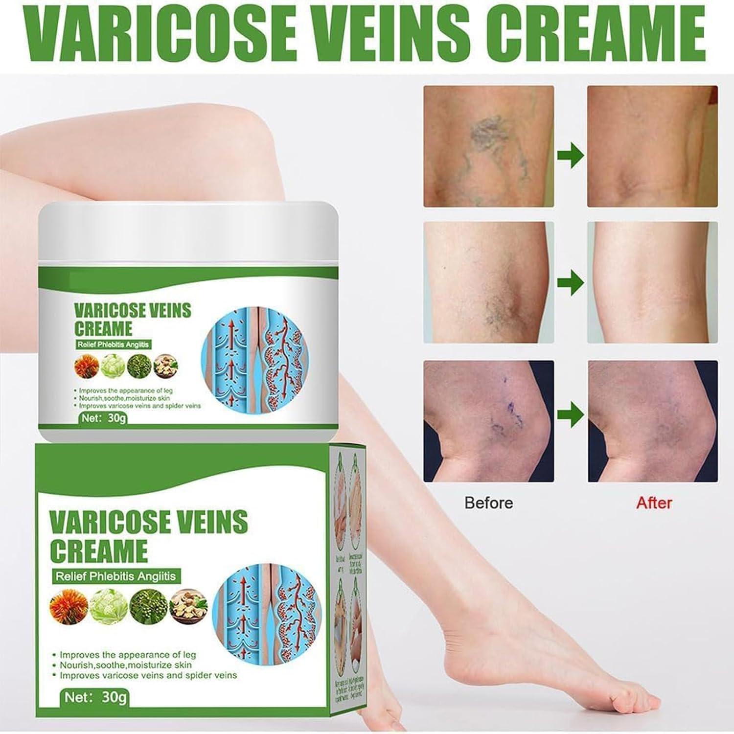 Varicose Veins Cream - 2pcs for Relief of Phlebitis, Angiitis ...