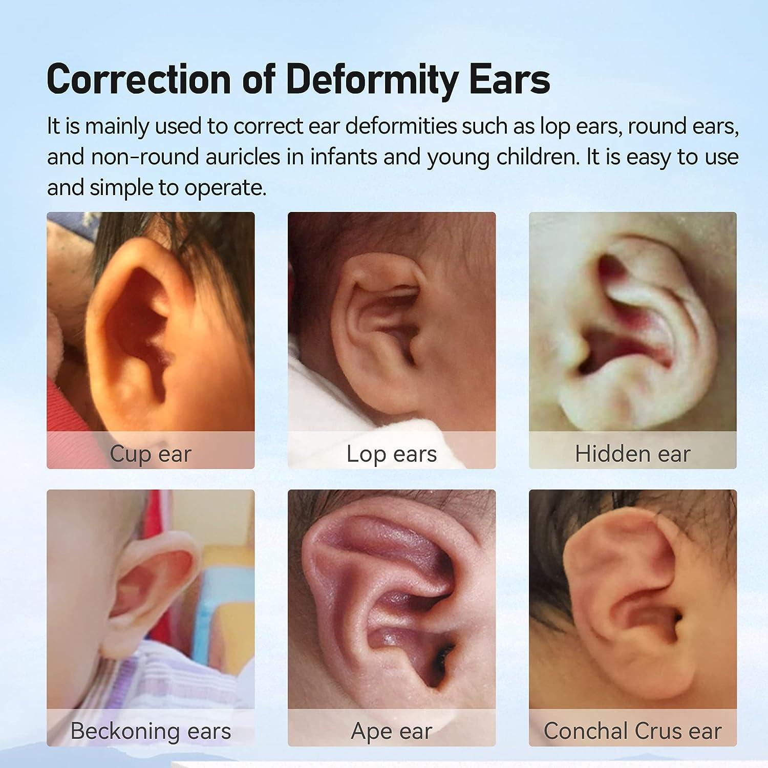 Sanfe Elephant Protruding Ear Corrector - Orthopedic Baby Item for ...