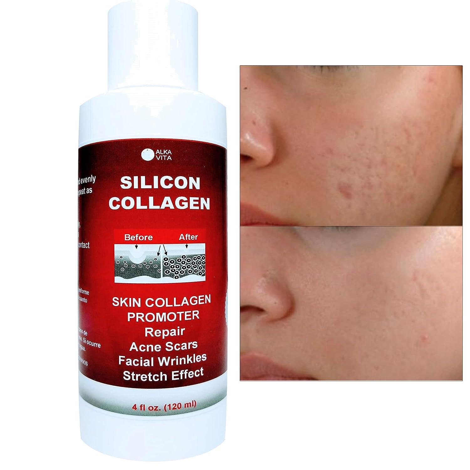 ALKA VITA Silicon & Collagen Gel for Indented Facial Scars - Skin ...