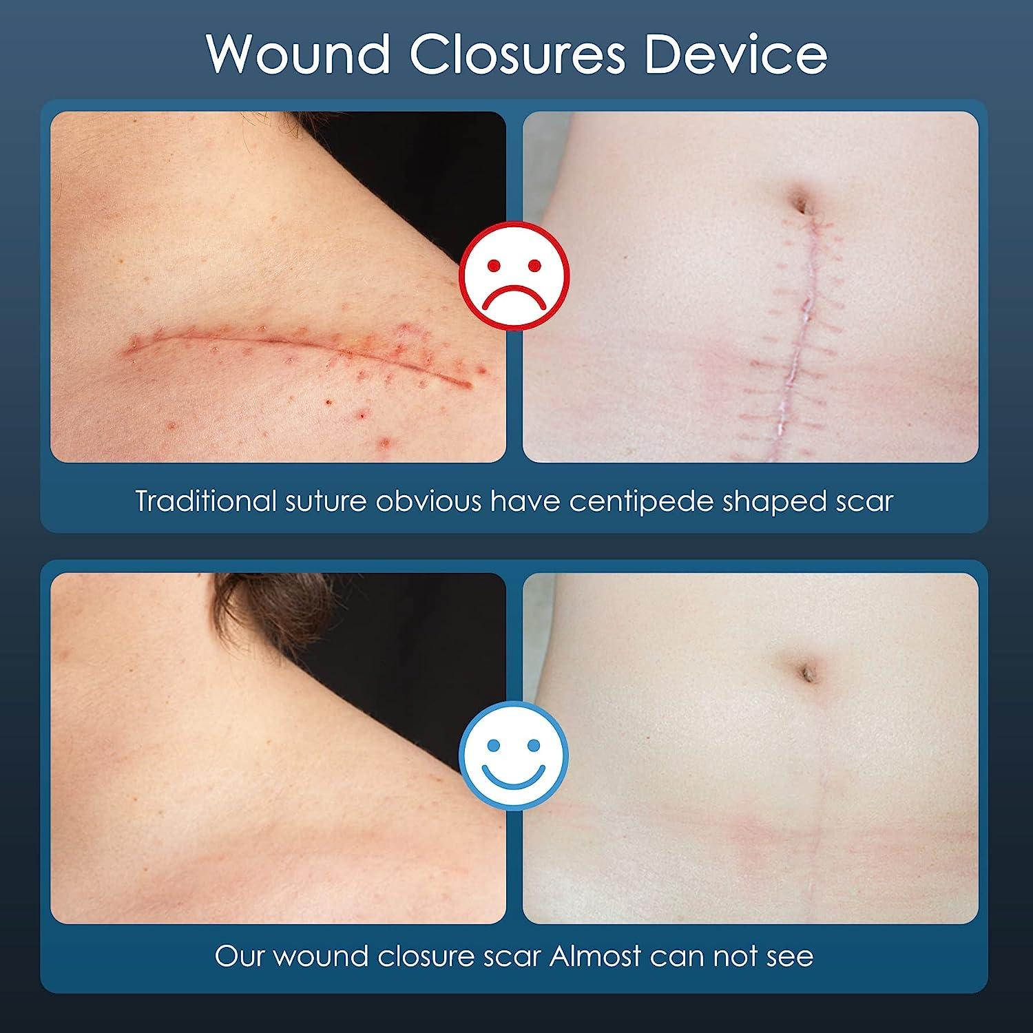 Wound Closure Strip 6 pcs - Sterile First Aid Kit Zip & Stitch Suture ...