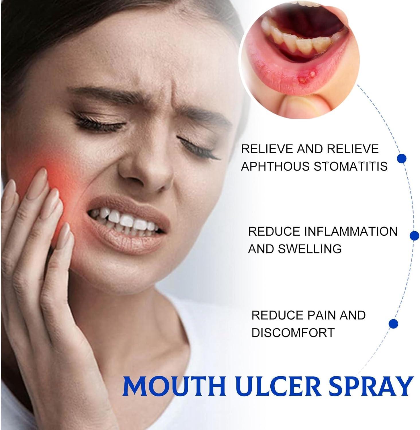 Mouth Ulcer Spray Ulcer Breath Sprays Mouth Ulcer Treatment Spray Ulcer ...