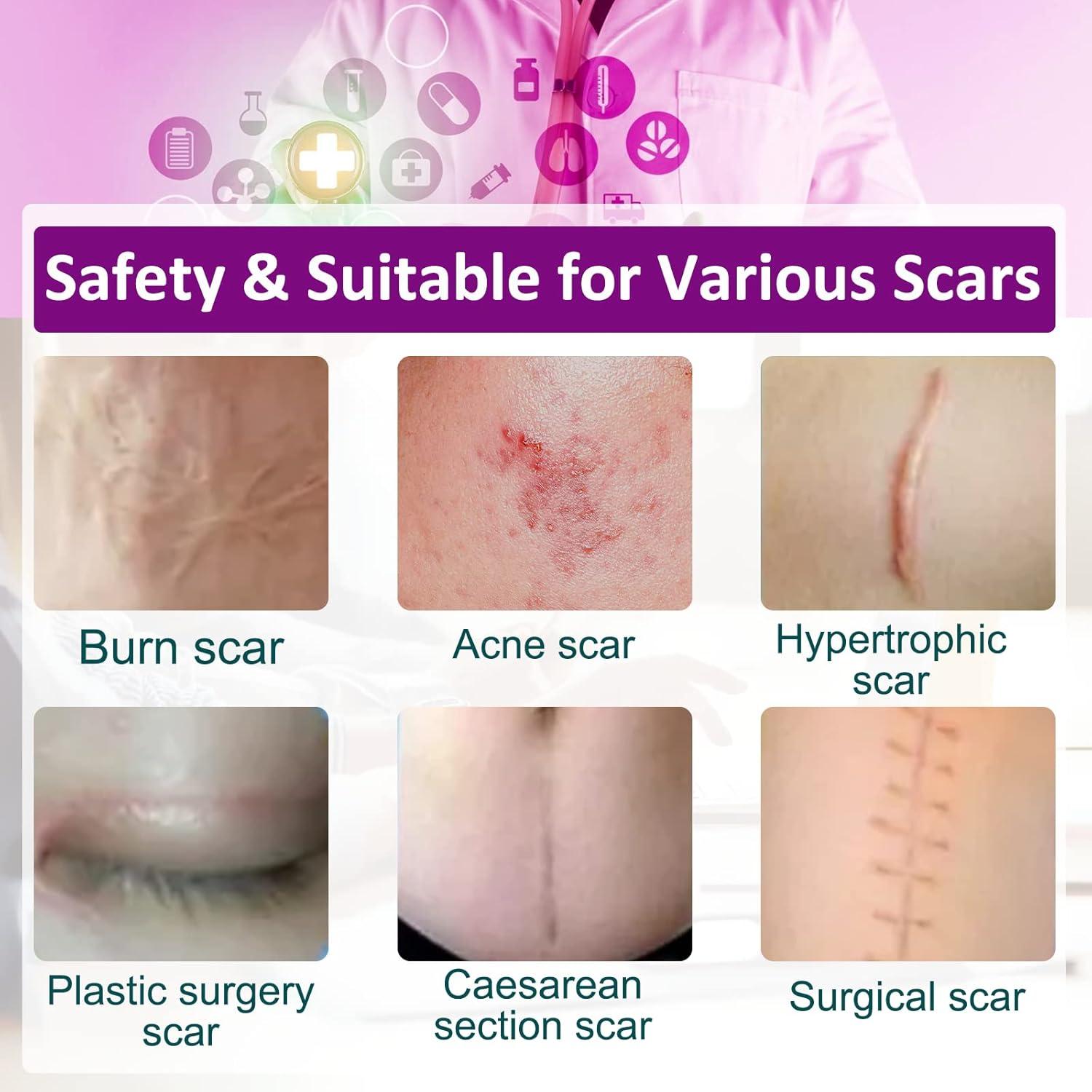 Silicone Scar Sheets - Clear Invisible Tape for Surgical C-Section ...