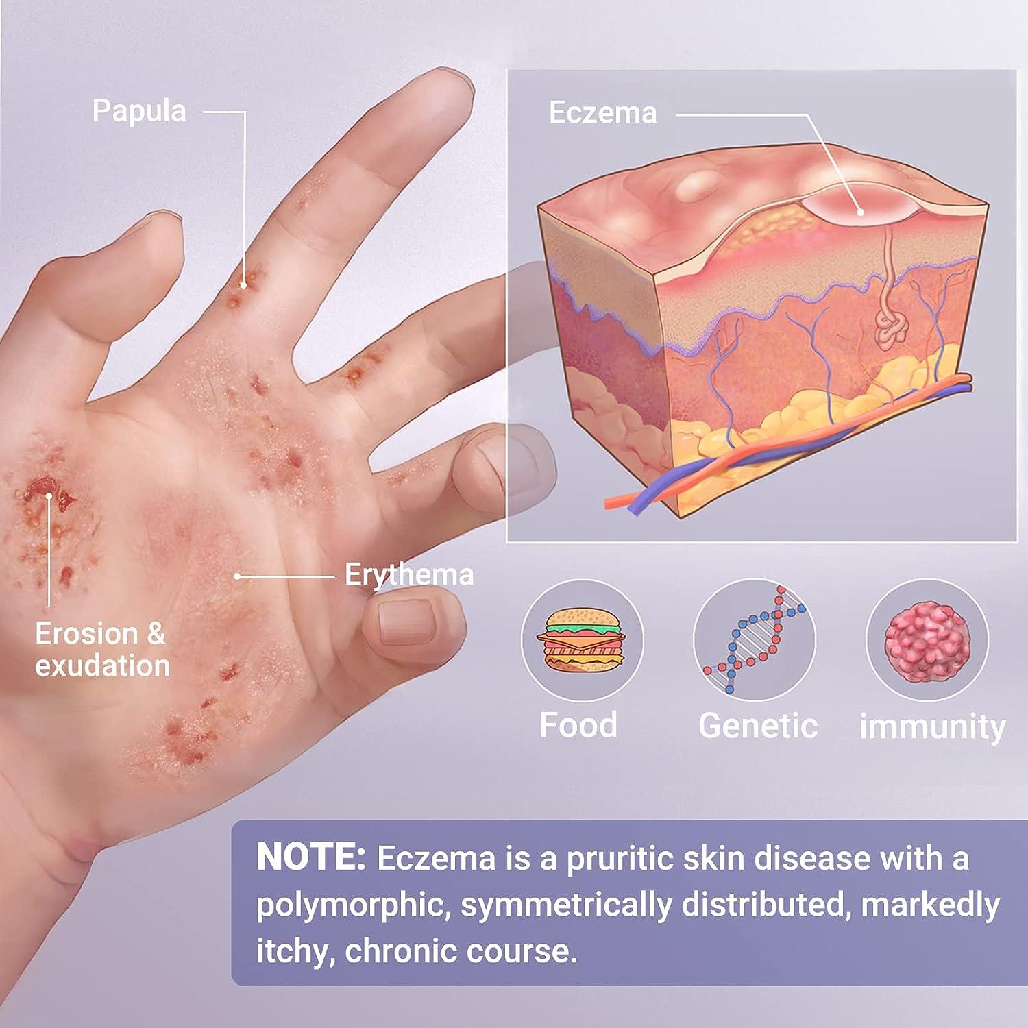 Ishancare Eczema Cream Maximum Treatment Ointment - Fast Relief for ...