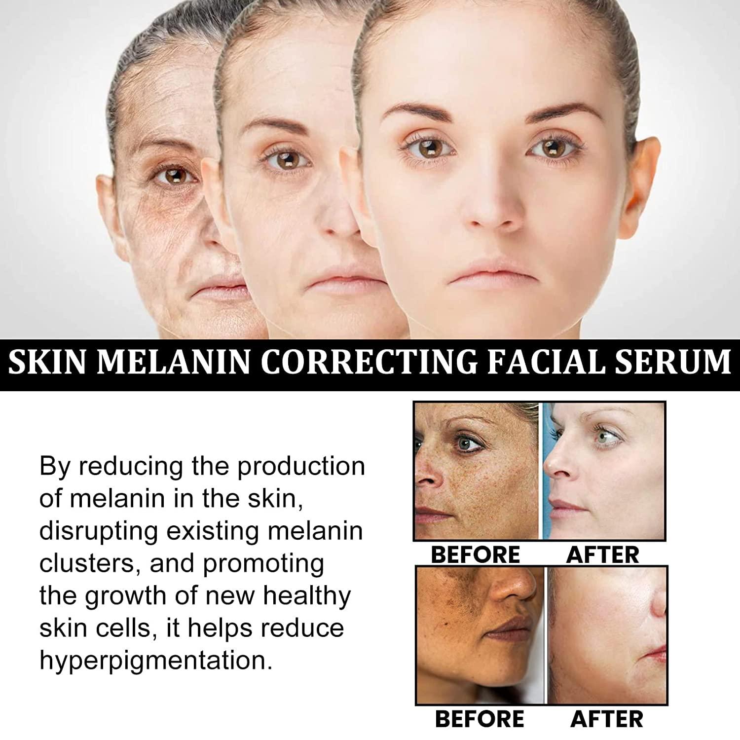 Melanin Correcting Vitamin C Facial Serum with Dark Spot Corrector ...