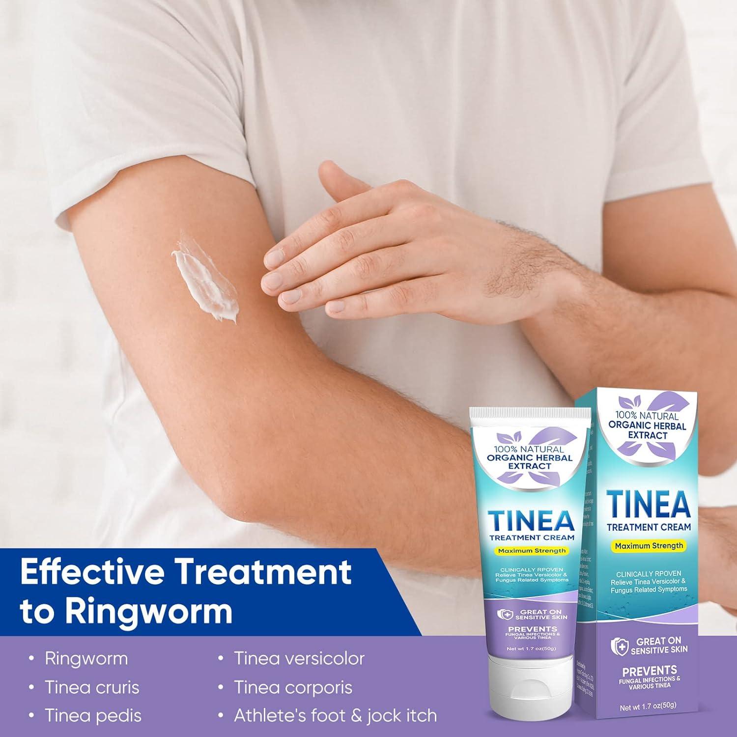 Tinea Versicolor Natural Skin Cream - Effective Treatment for All Skin ...