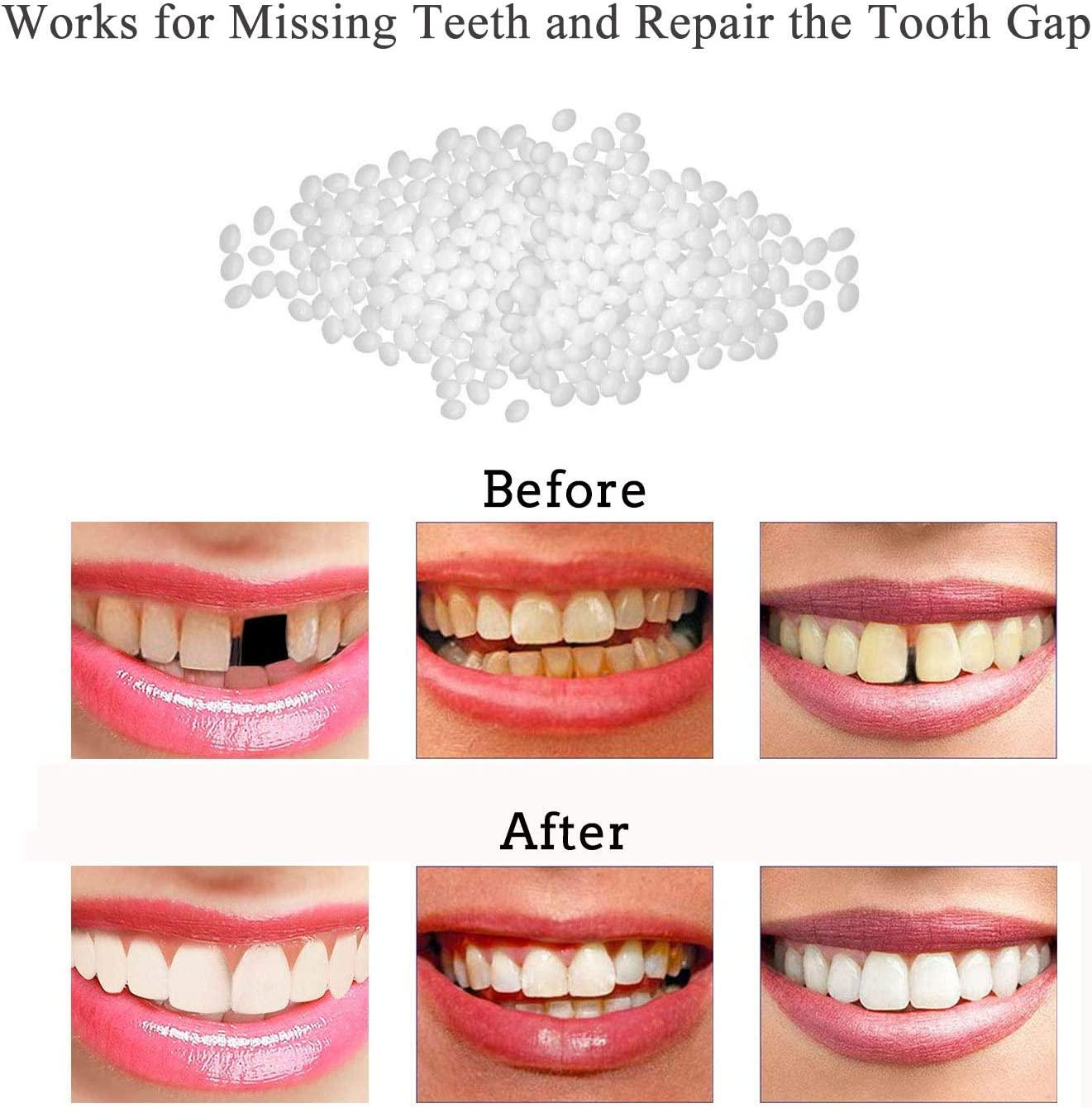 Temporary Tooth Repair Kit with Thermal Beads - Fill and Fix Missing or ...