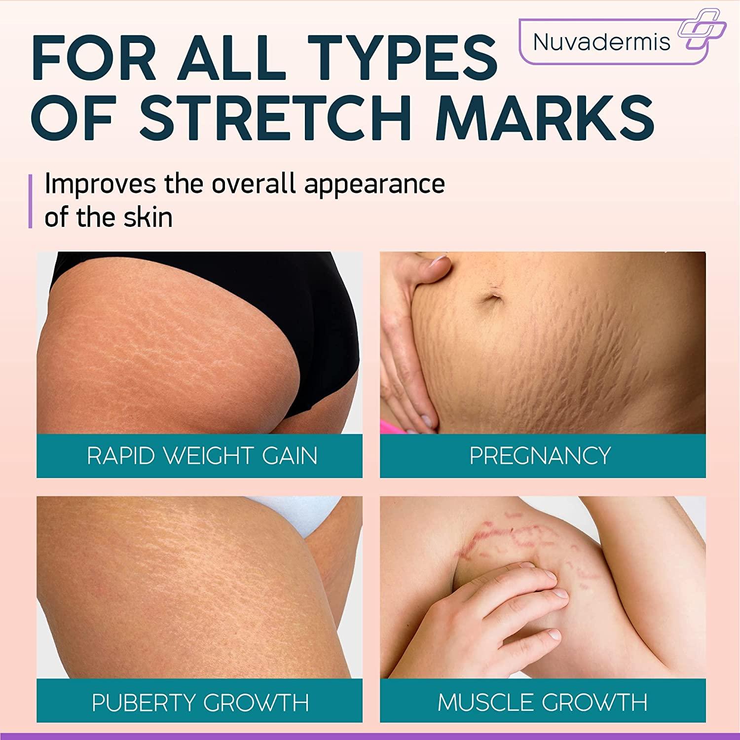 Stretch Mark Cream - Maternity Skin Care with Collagen, Jojoba, and Olive Oil - Prevents and ...