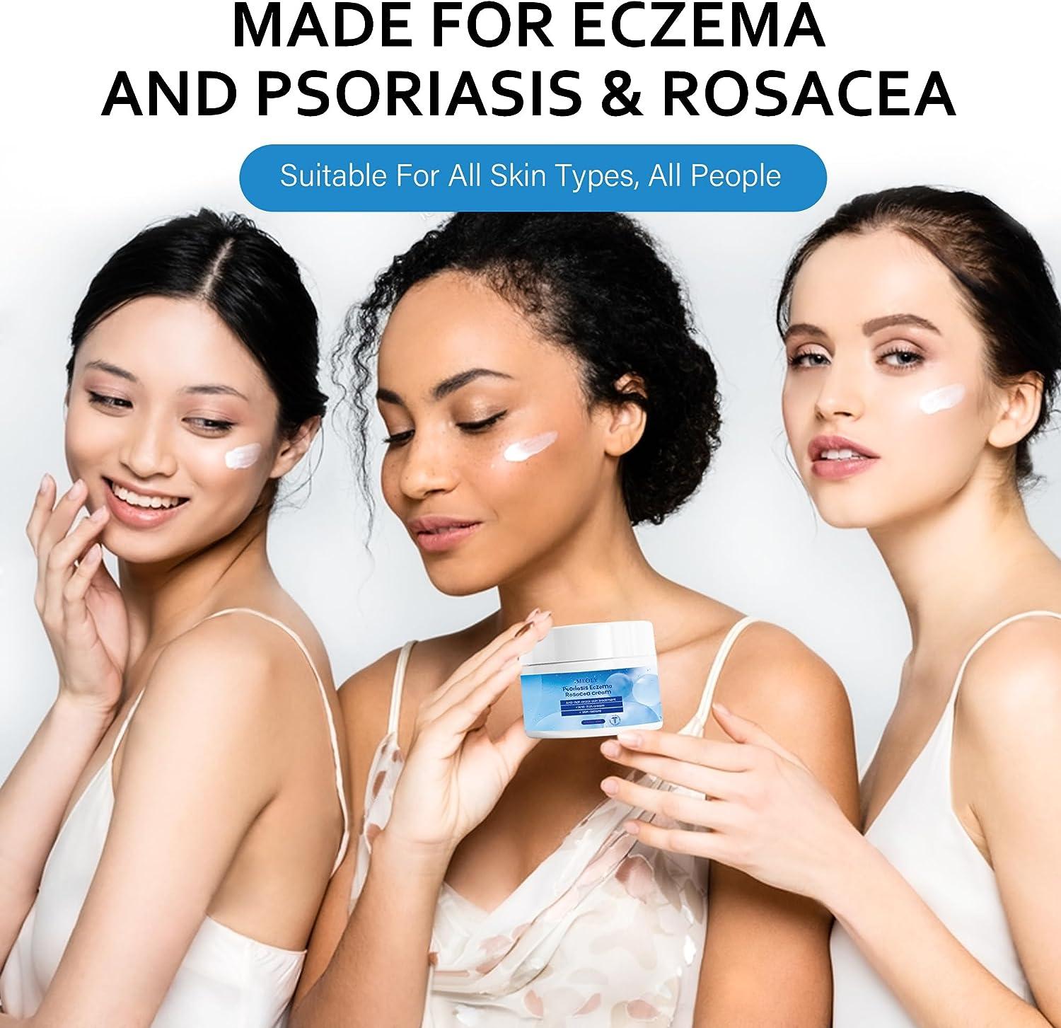 MEOLY Psoriasis Eczema Rosacea Cream 60 ML - Anti-Itch & Dry Skin ...