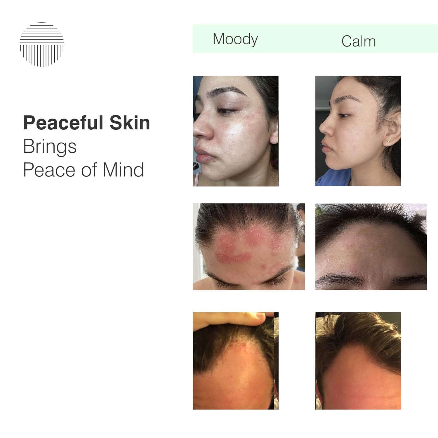 Dermazen Calming Seborrheic Serum - Dermatologist Recommended for Hair ...