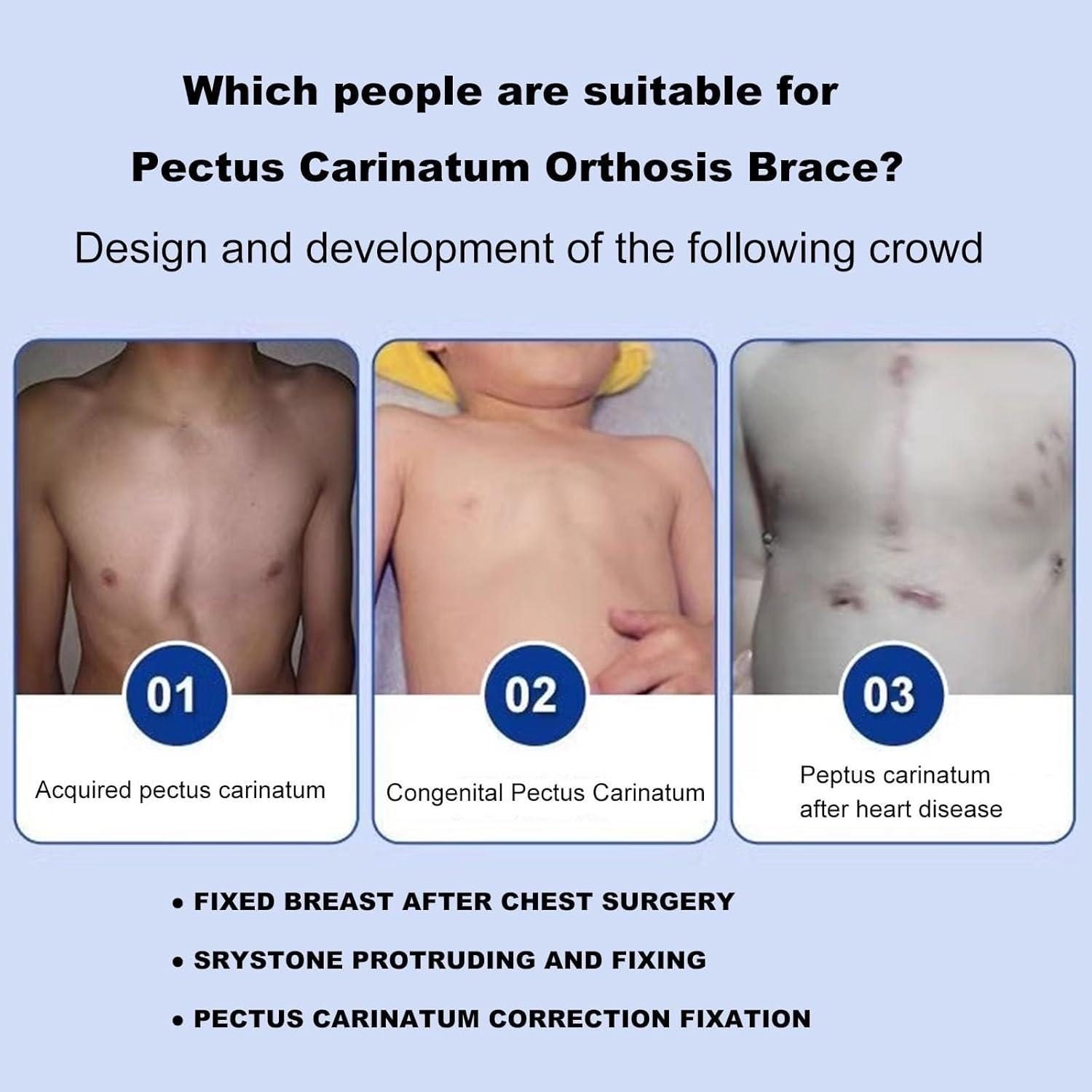 pectus carinatum