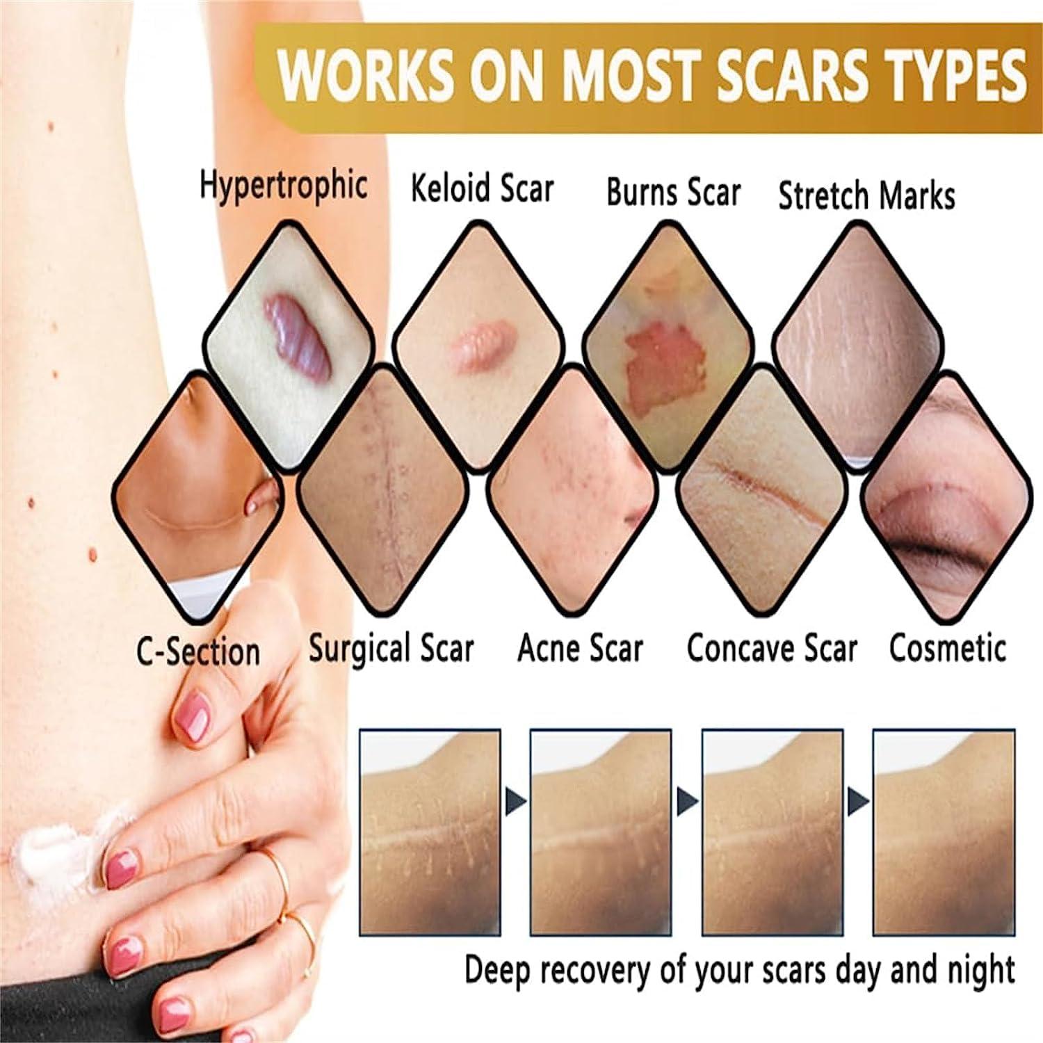 Klearscar Advanced Scar Removal Gel - Medical Grade Scar Lotion for All ...