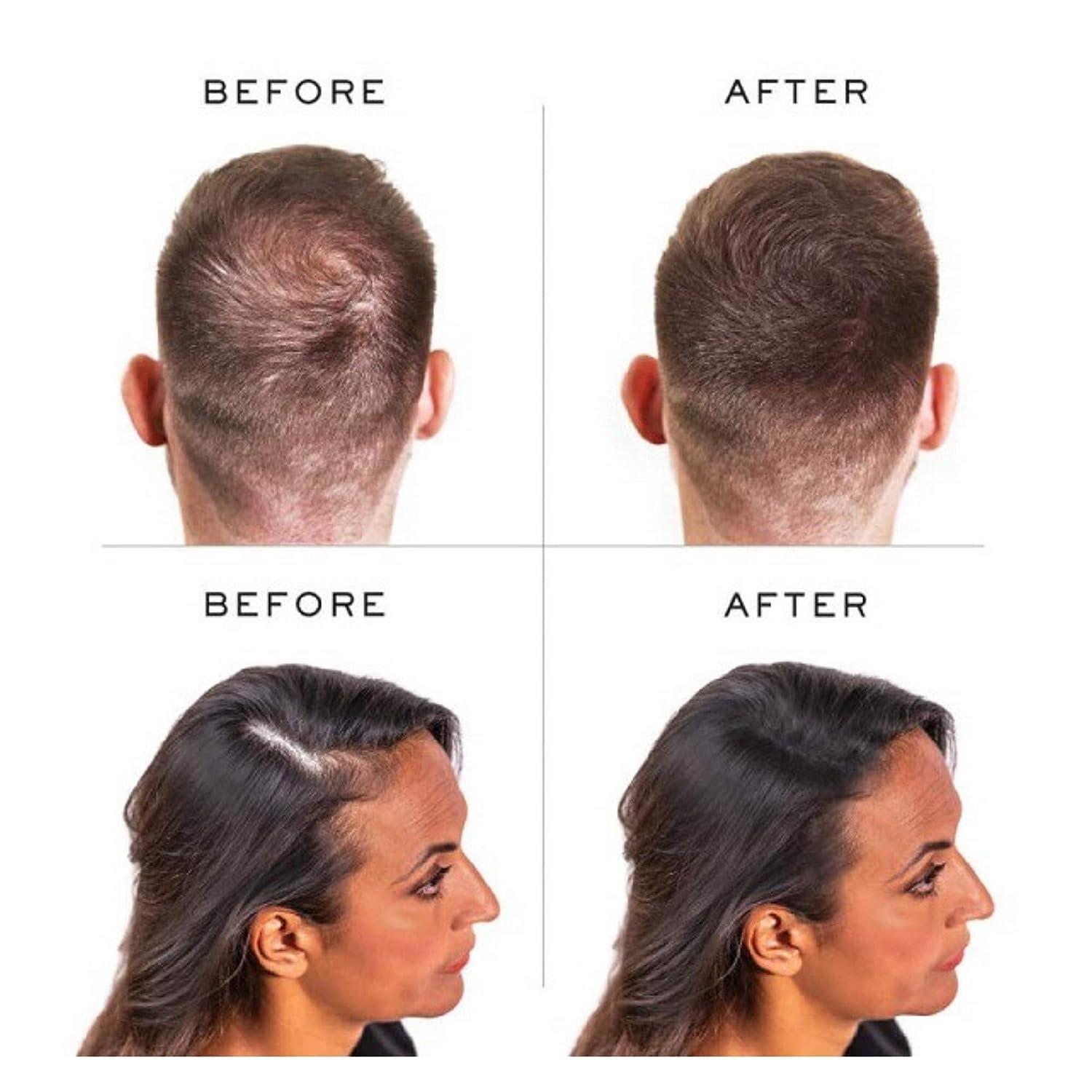 PROCOVR Hair Loss Concealer Cream with DHT Blockers - Saw Palmetto ...