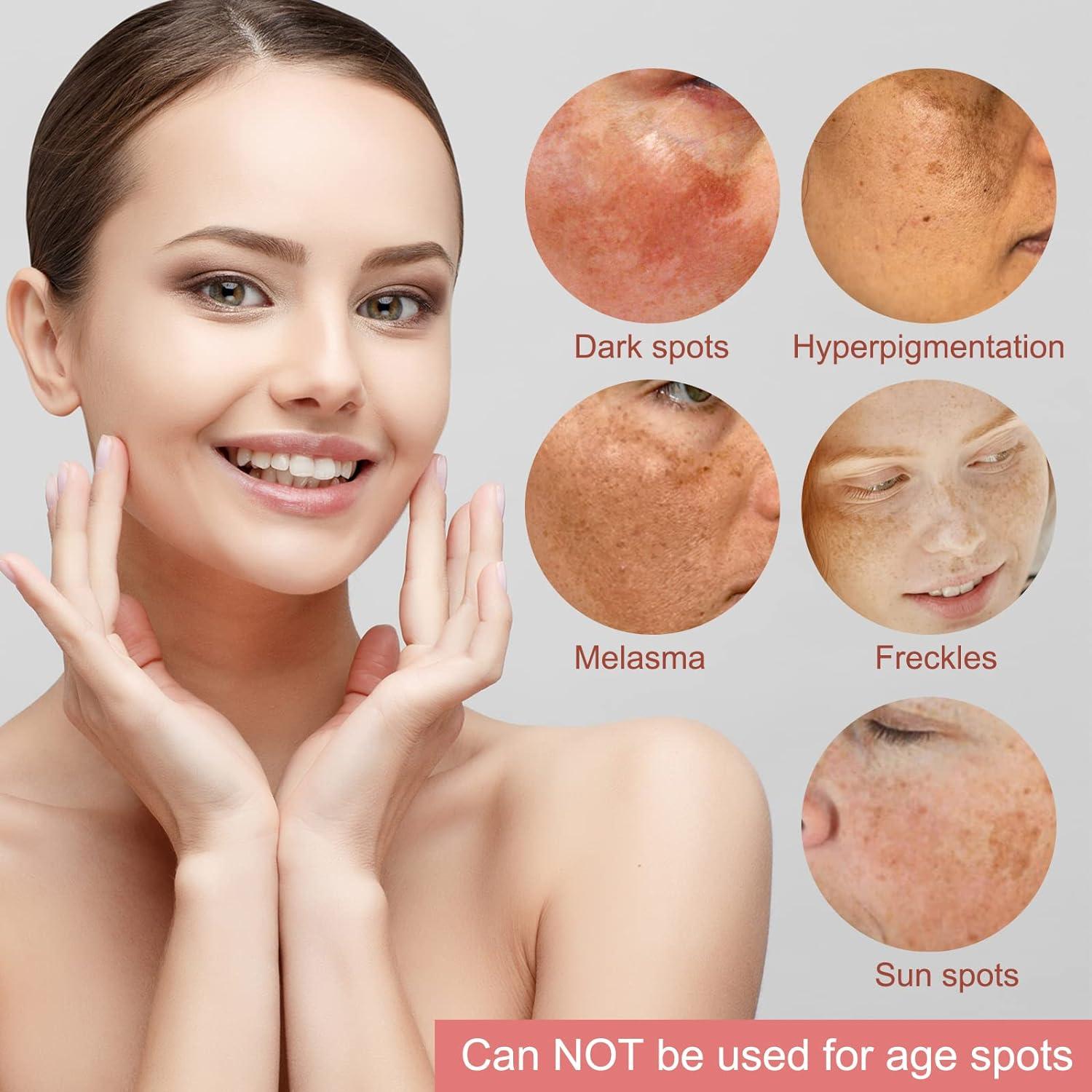 Dark Spot Remover for Face and Body - Melasma, Sun Spots, Freckle, Hyperpigmentation Treatment ...