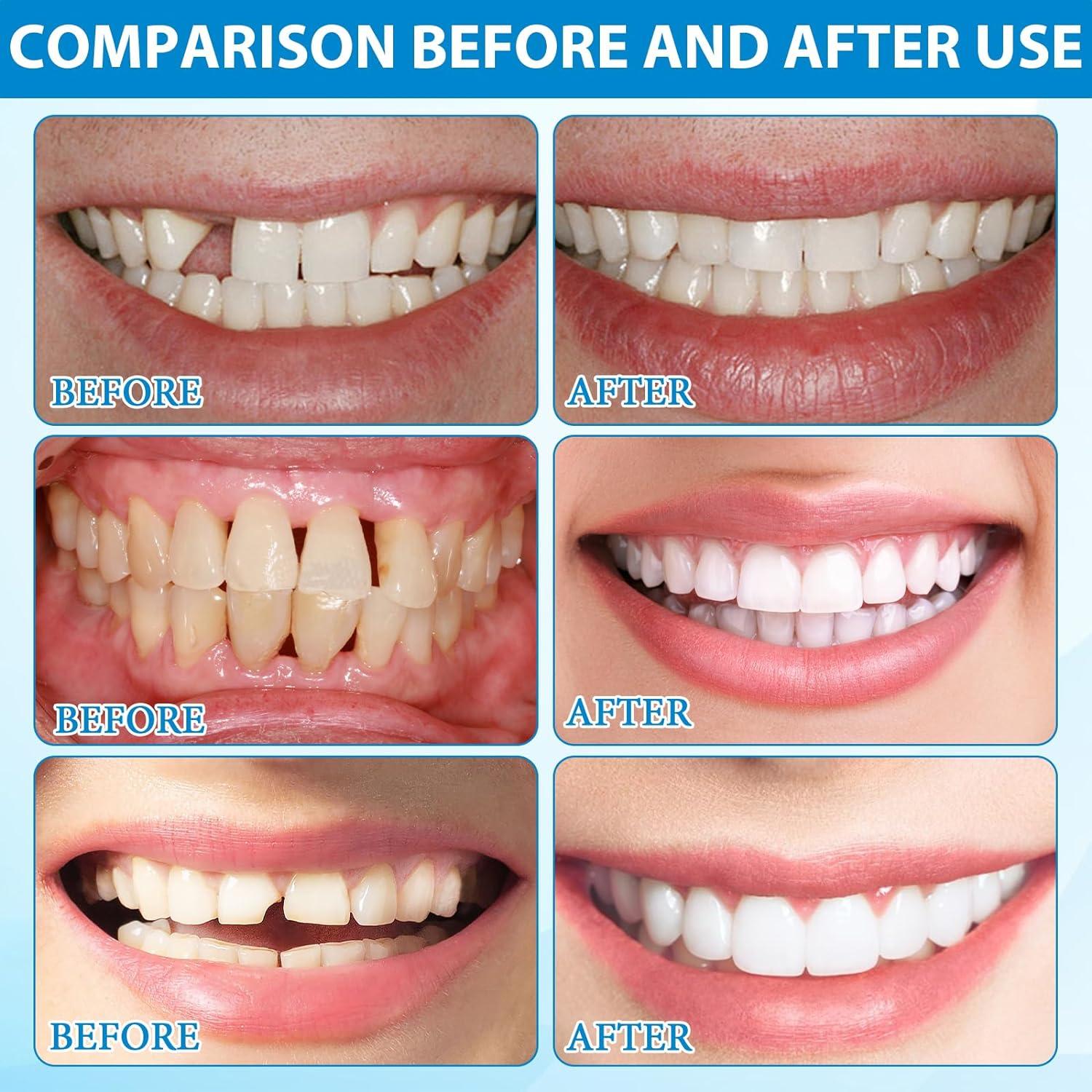 Temporary Tooth Filling Tooth Repair Kit with Tweezers DIY Temporary ...