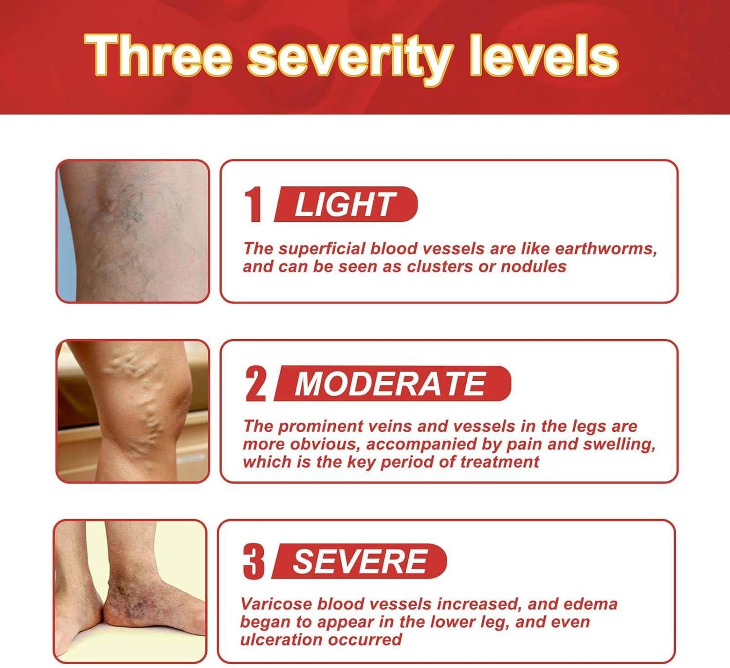 3 & 12 Piece Venous Plaster for Varicose Veins - Soothing Stickers to ...