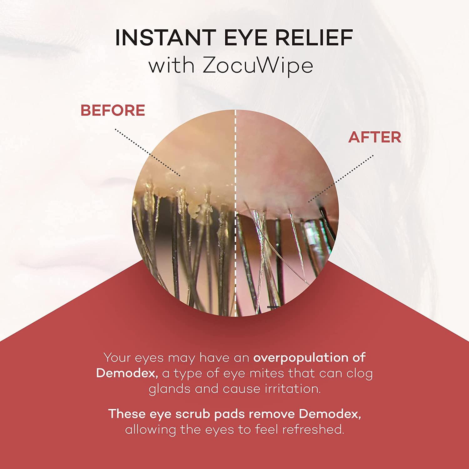 Zocuwipe Eyelid Wipes with Okra Complex - Eyelid Cleanser and ...