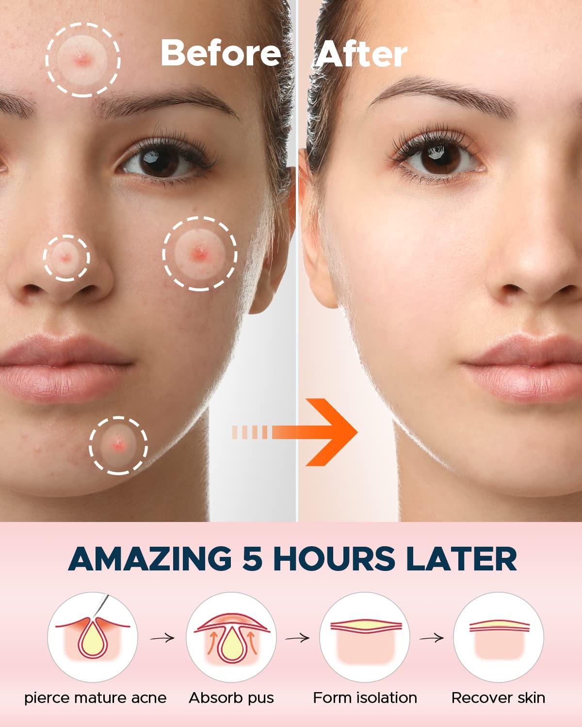 176 Hydrocolloid Acne Patches + Pimple Extractor Tool | Tea Tree ...