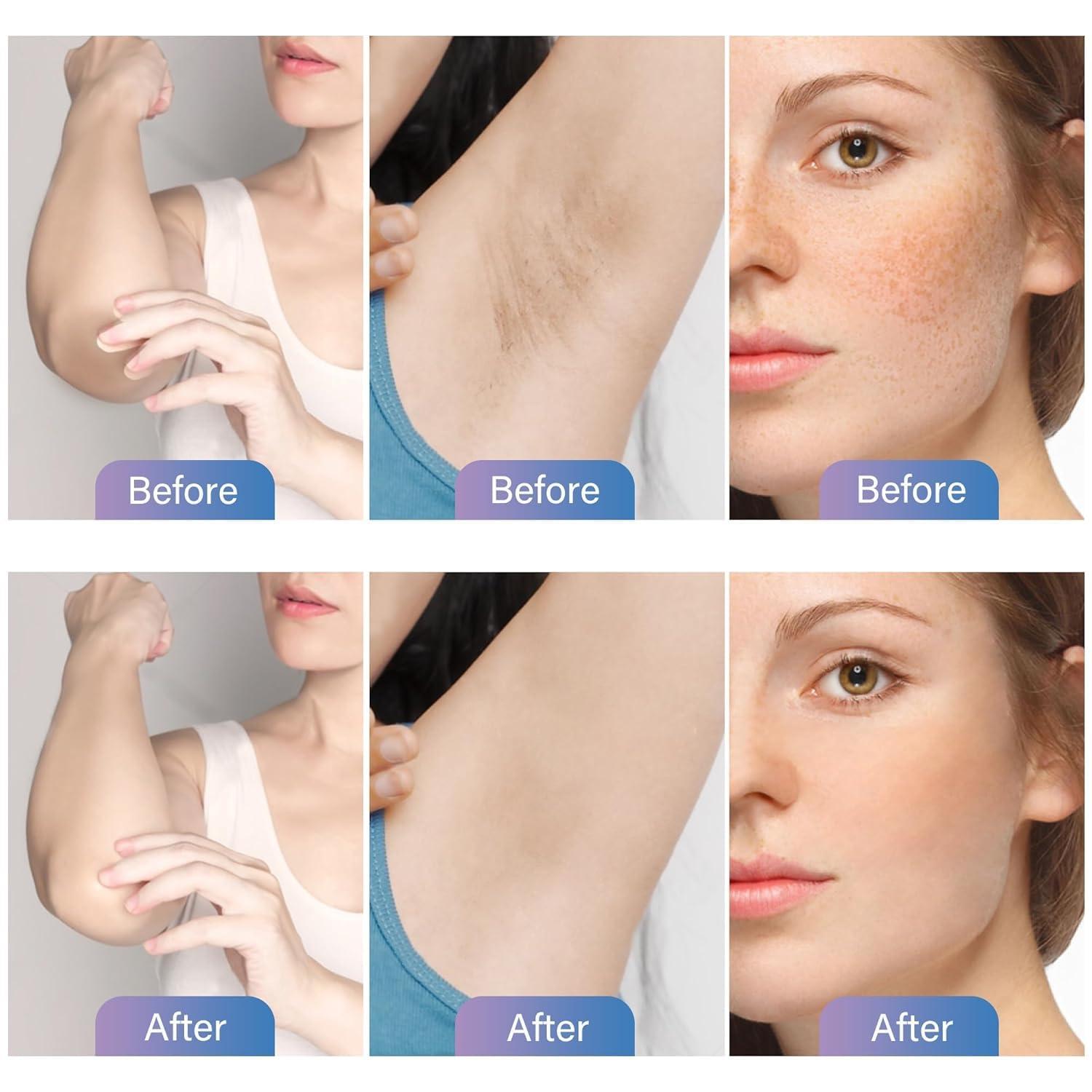 hyperpigmentation face acid