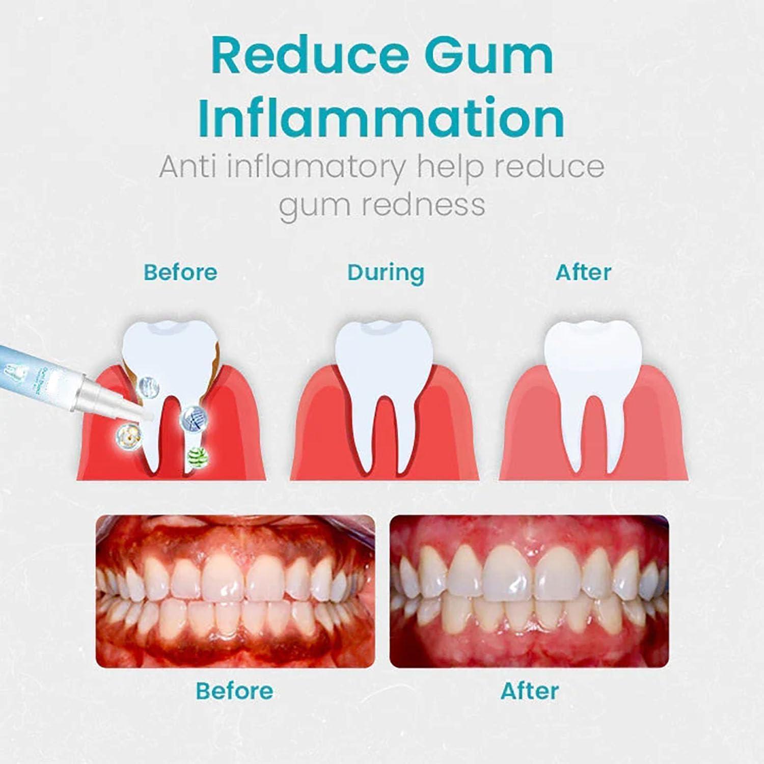 Premium Gum Shield Therapy Gel & Teeth Whitening Pen - Instant ...