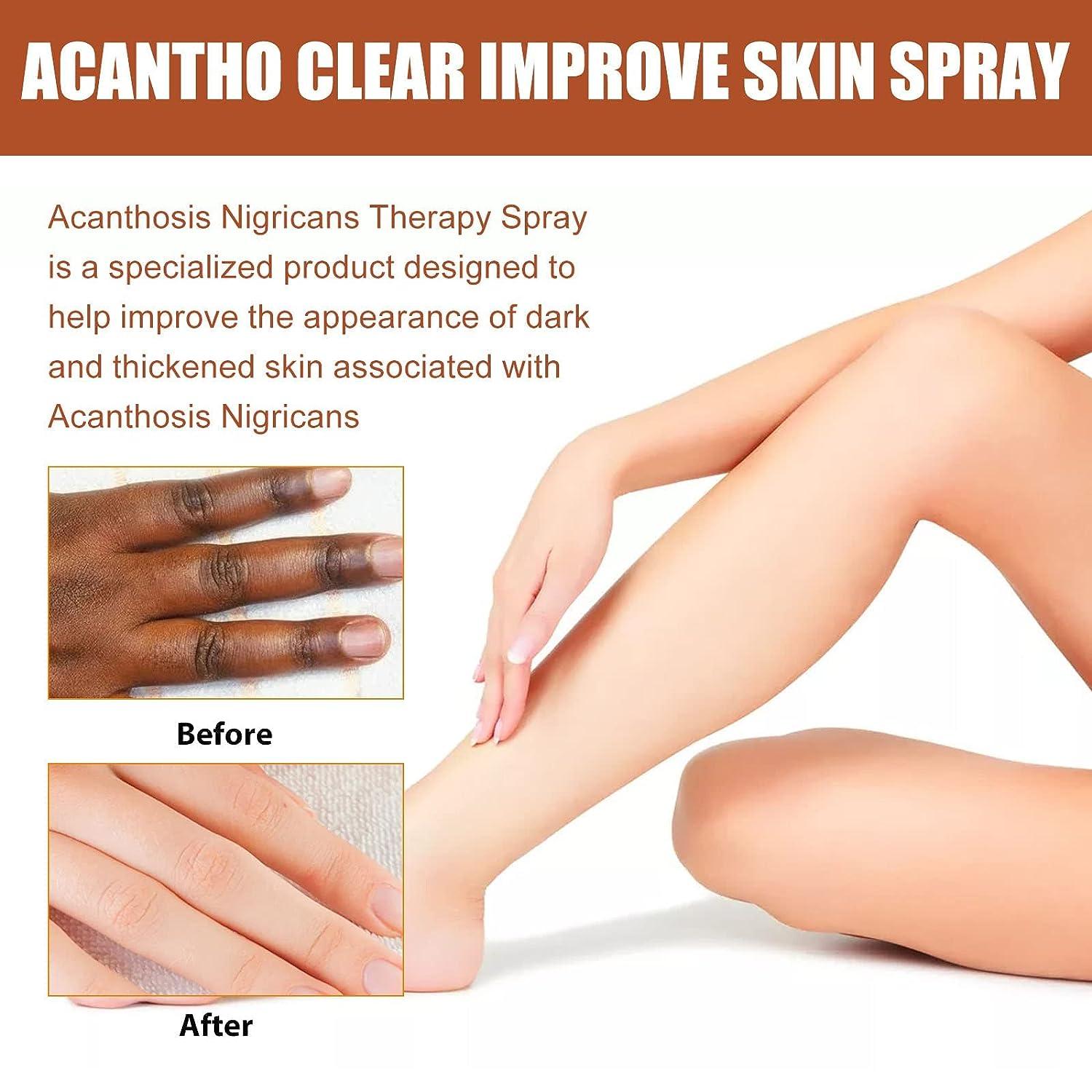 TRIMADE Acantho Clear Therapy Spray - Dark Spot Remover & Skin ...