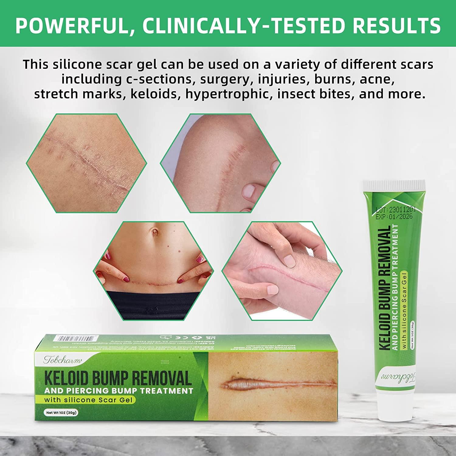 Tobcharm Keloid Scar Removal Gel - Effective Treatment for Piercing ...