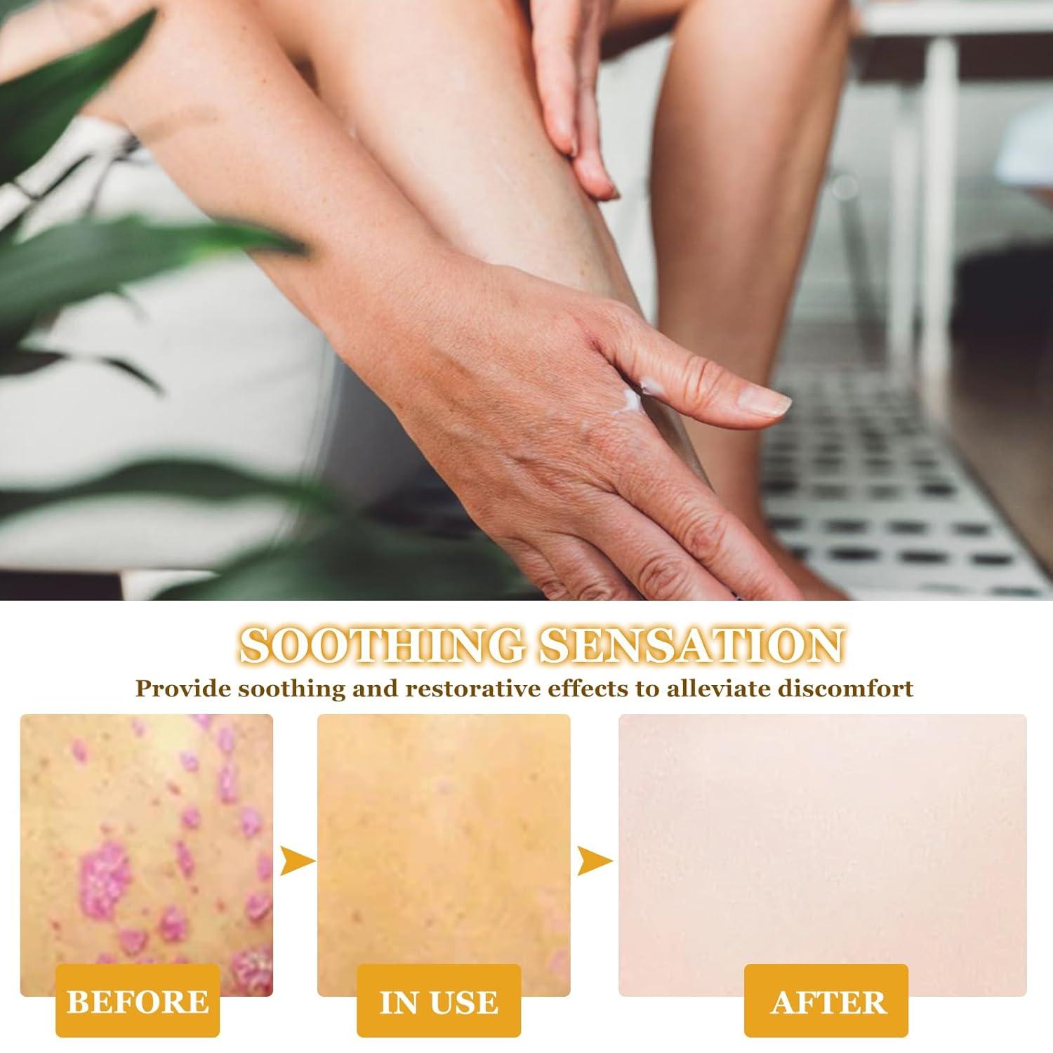 Beeergift Salbe Cream for Psoriasis | Professional Bee Venom Skin ...