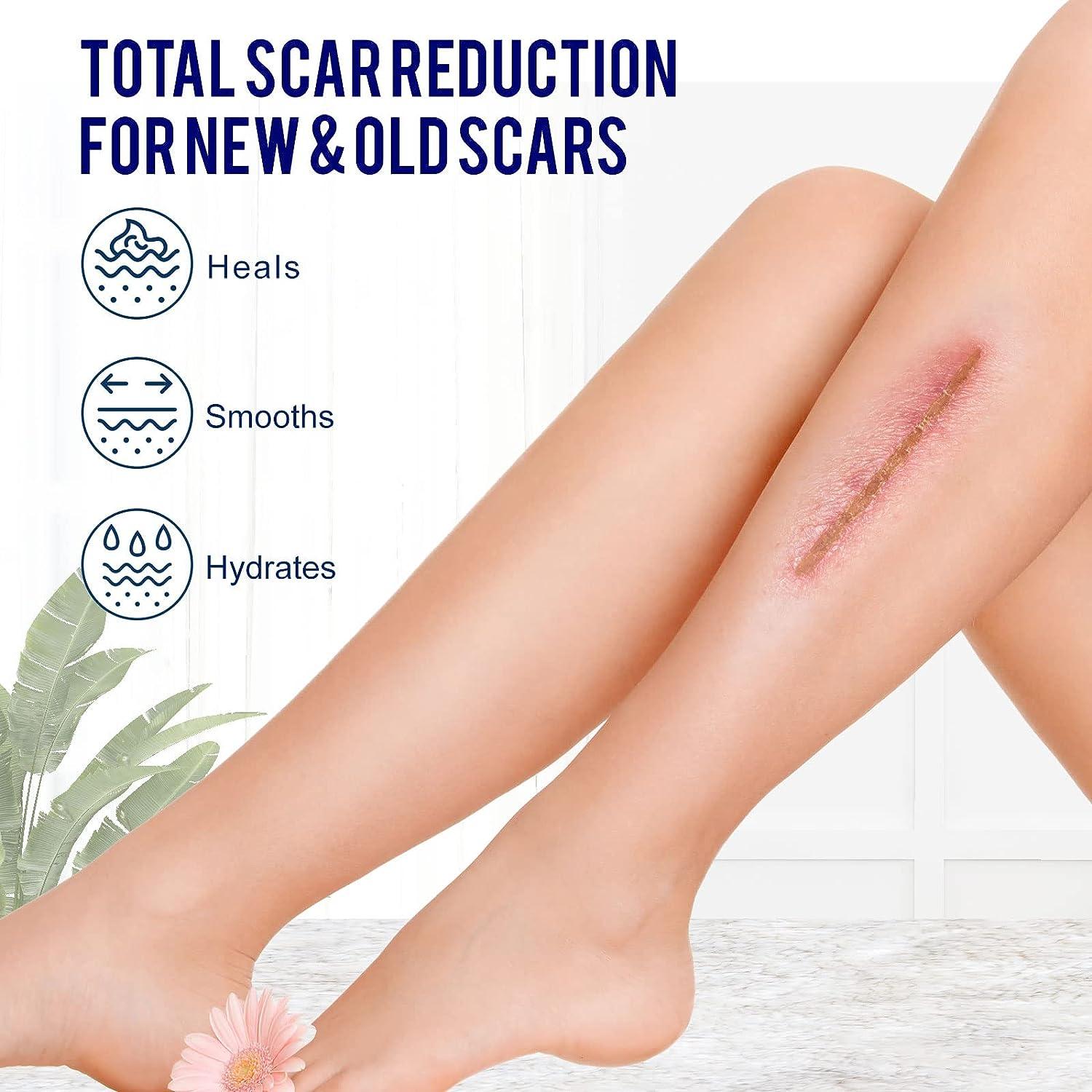 Scar Cream Gel with Retinol, Allantoin & Vitamin E - Advanced Scar ...