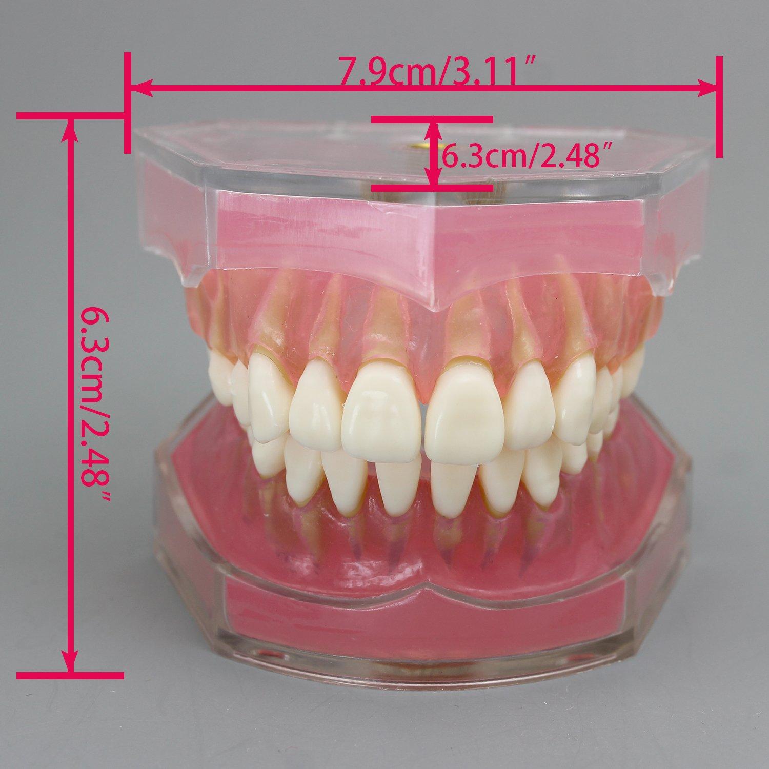 Dental Implant Teeth Model - Standard Study and Teaching Tool with ...