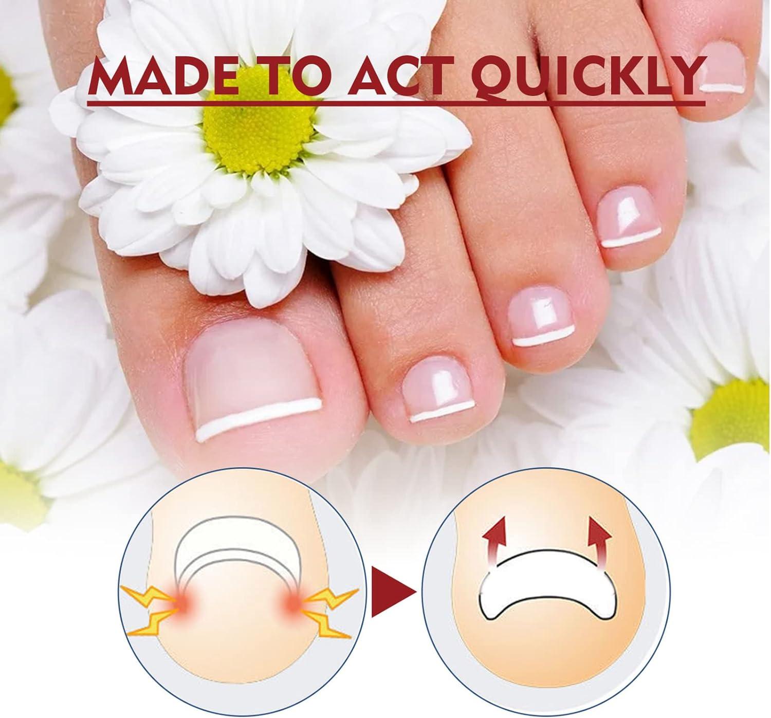 Toenailplus Anti Paronychia Relief Oil - 10ml 2pcs - Nail Helper for ...