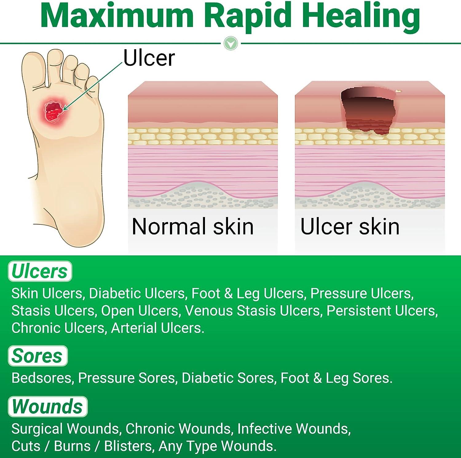 LMNOOP Skin Ulcer Healing Ointment - Natural Ingredients for Foot, Leg ...