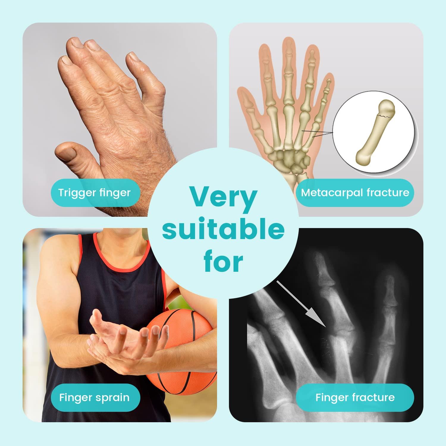 Adjustable Finger Rail Support - Orthosis for Finger Fractures ...