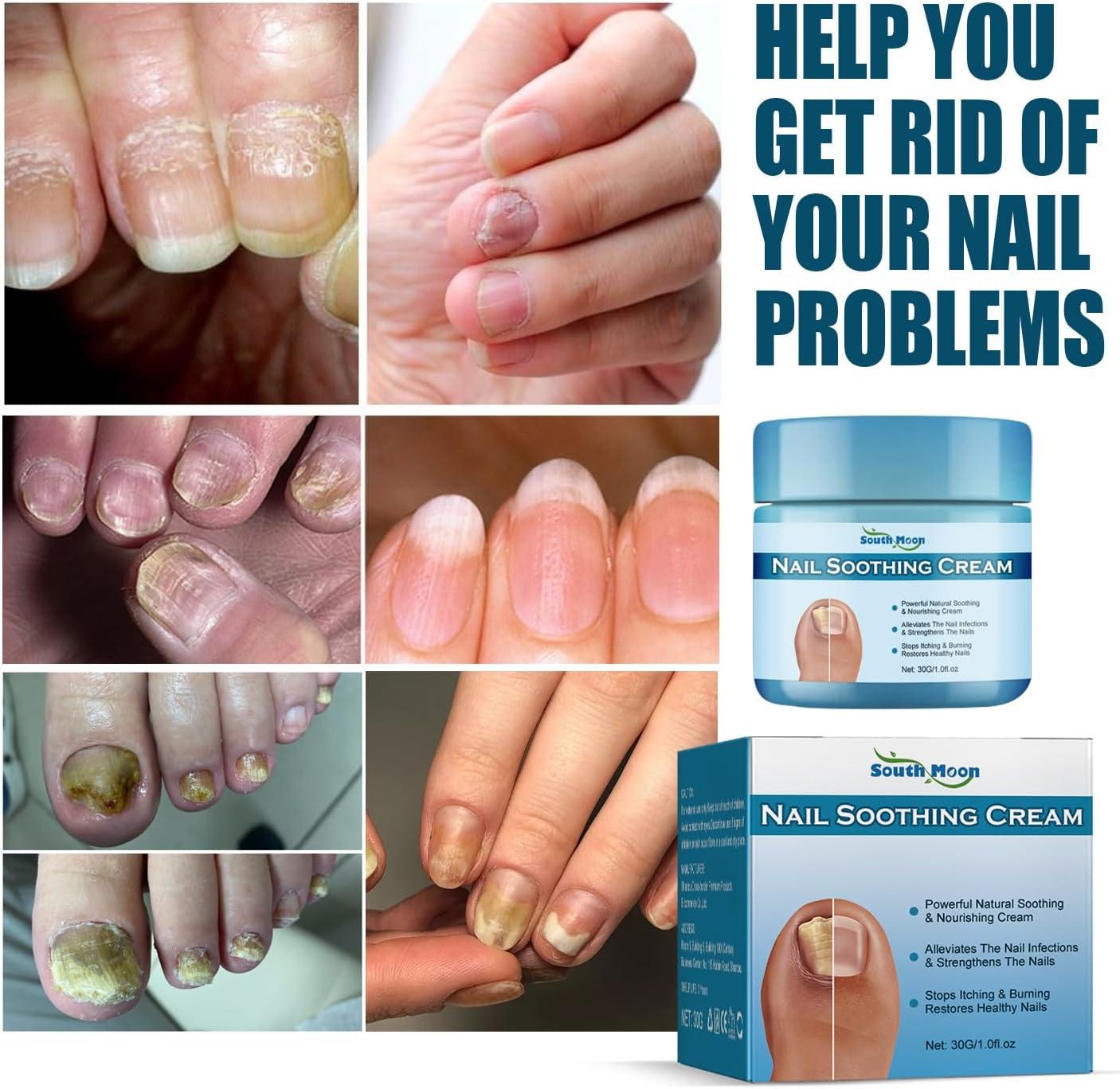 Multi-purpose Nail Repair for Fingernails Toenails Toe Nail Fungal ...