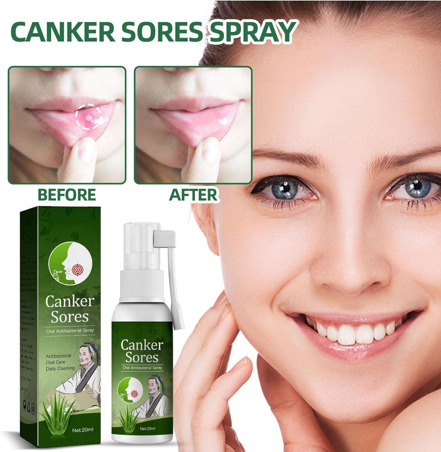 Oral Ulcer Relief Spray 20ml - Canker Sore & Gum Pain Relief Treatment ...