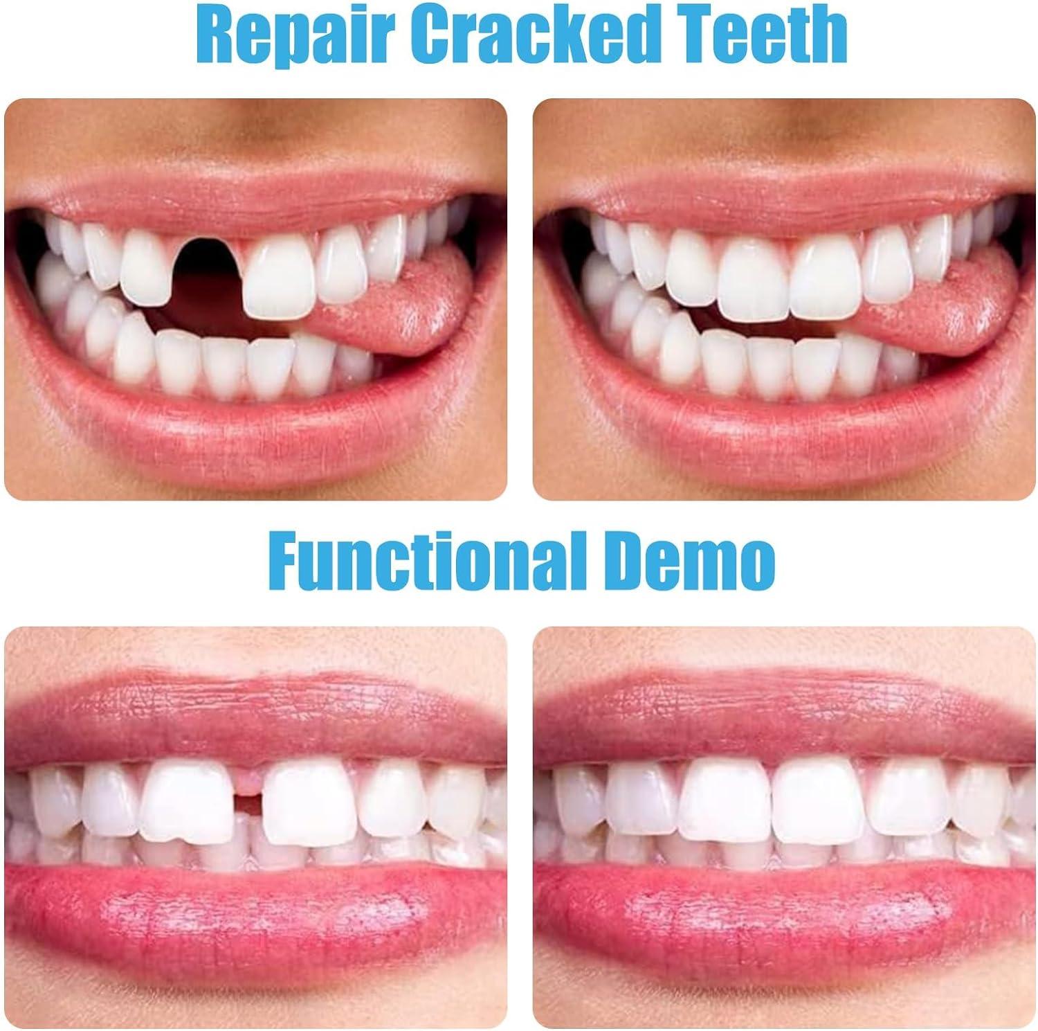 INBOLM Temporary Tooth Filling Repair Kit - DIY Moldable False Teeth ...