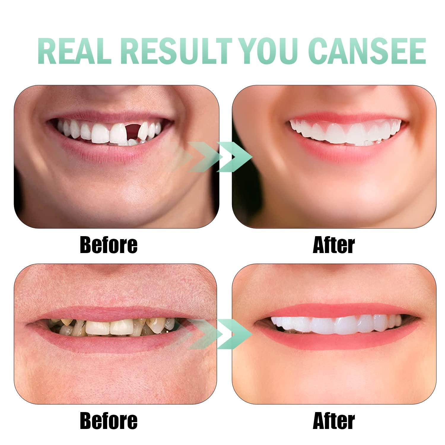 4 PCS Fake Teeth Veneers Dentures Kit for Women and Men - Temporary ...