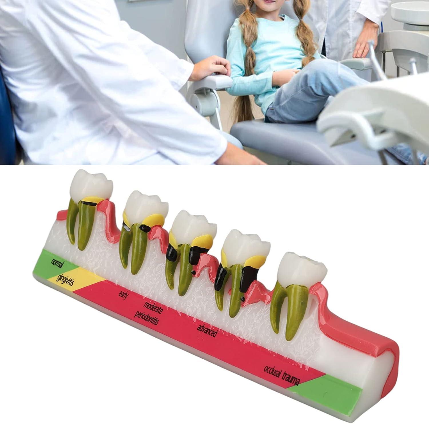 Realistic Dental Periodontitis Model - Study Dental Teeth in Various ...