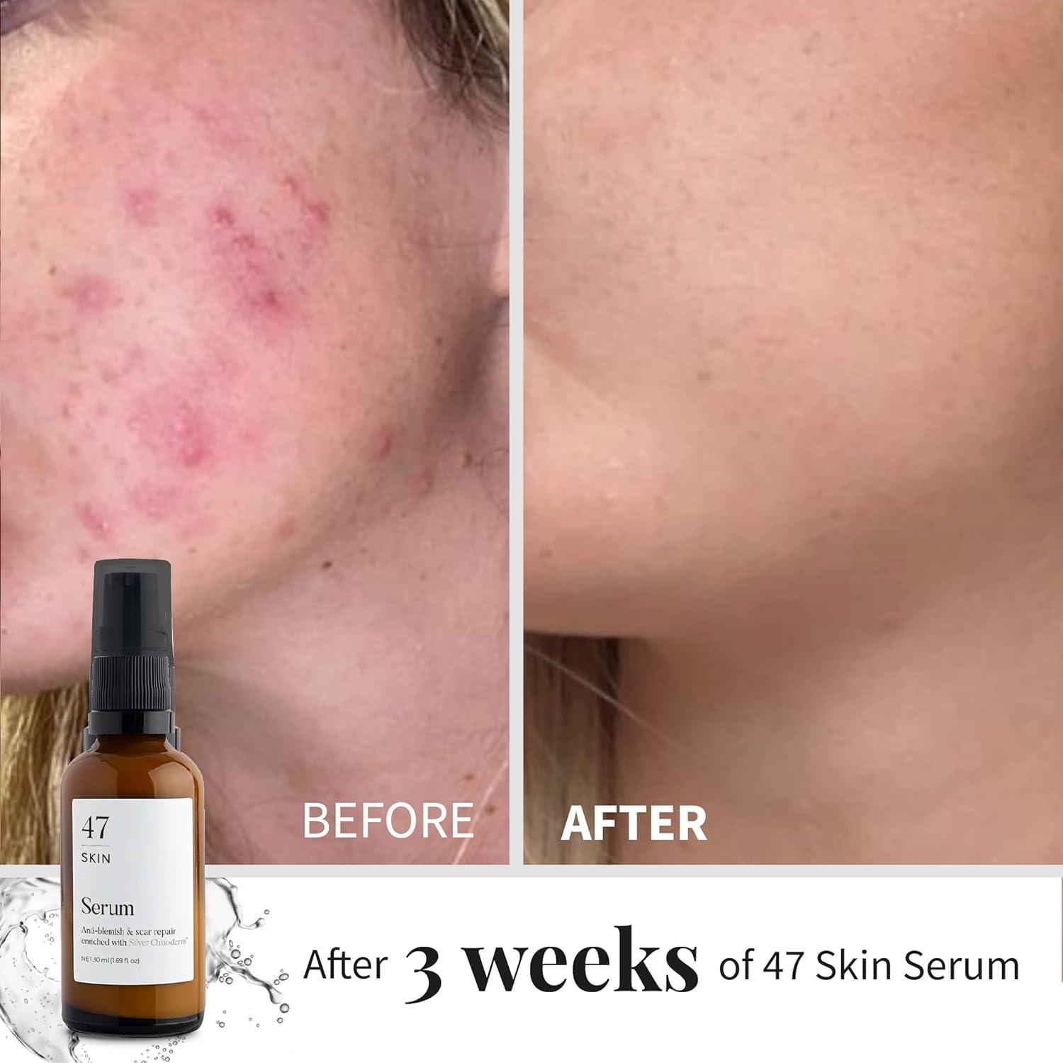 47 Skin Hydrating Face Serum for Acne and Scars - Anti-Blemish & Scar ...