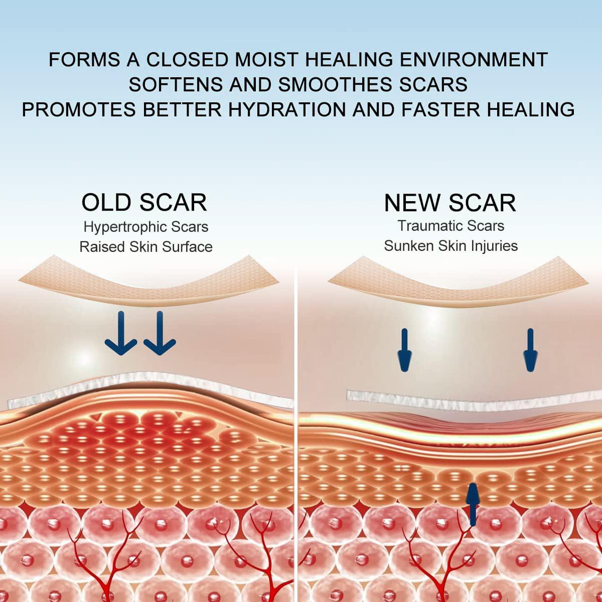 LOKFAM Silicone Scar Tape - Advanced Reusable Treatment for Surgical ...