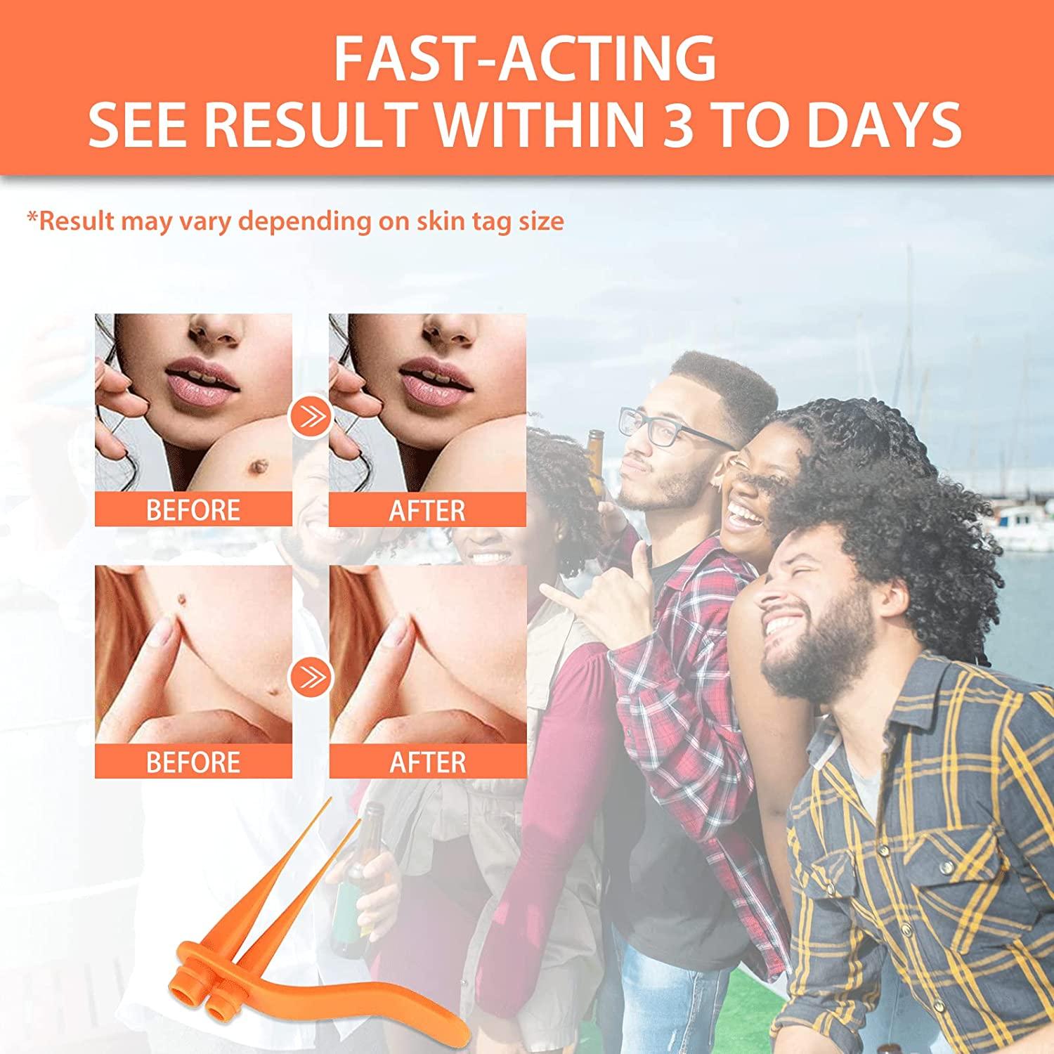2022 Skin Tag Remover Kit - 2-in-1 Patches for 2mm to 7mm Skin Tags ...