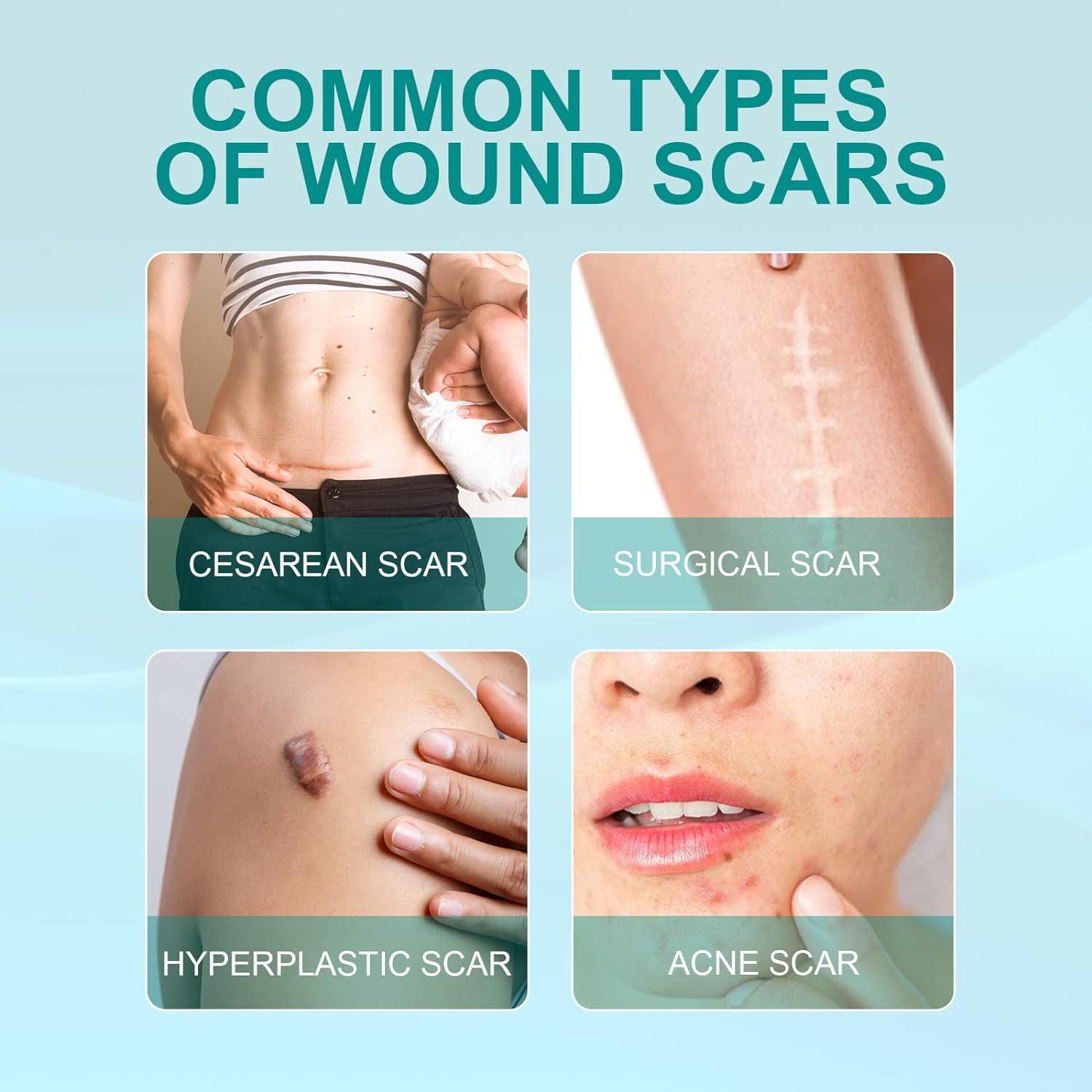 Proregen Scar Removal Spray - Medical Grade Scar Remover for Old and ...