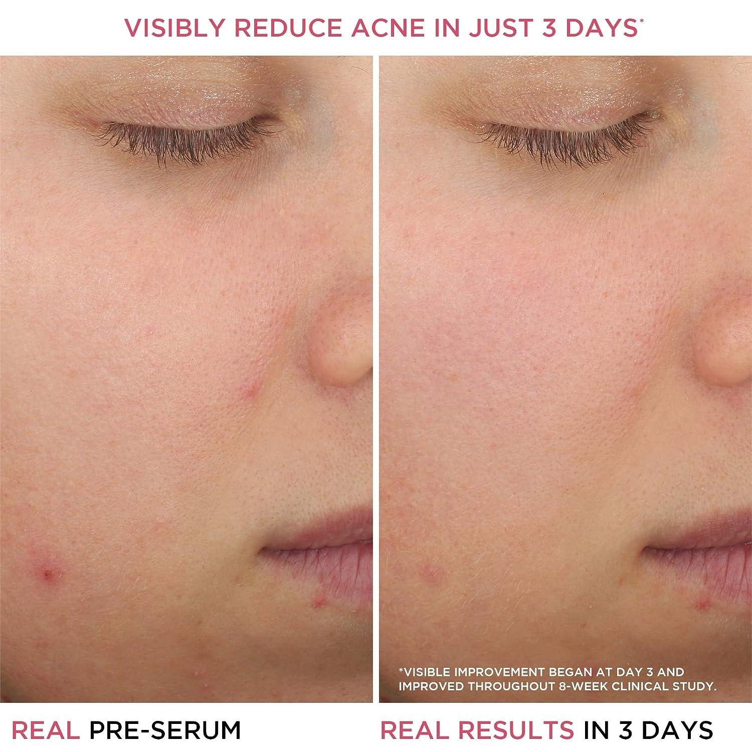 IT Cosmetics Bye Bye Breakout Acne Treatment Serum | 2% Salicylic Acid ...