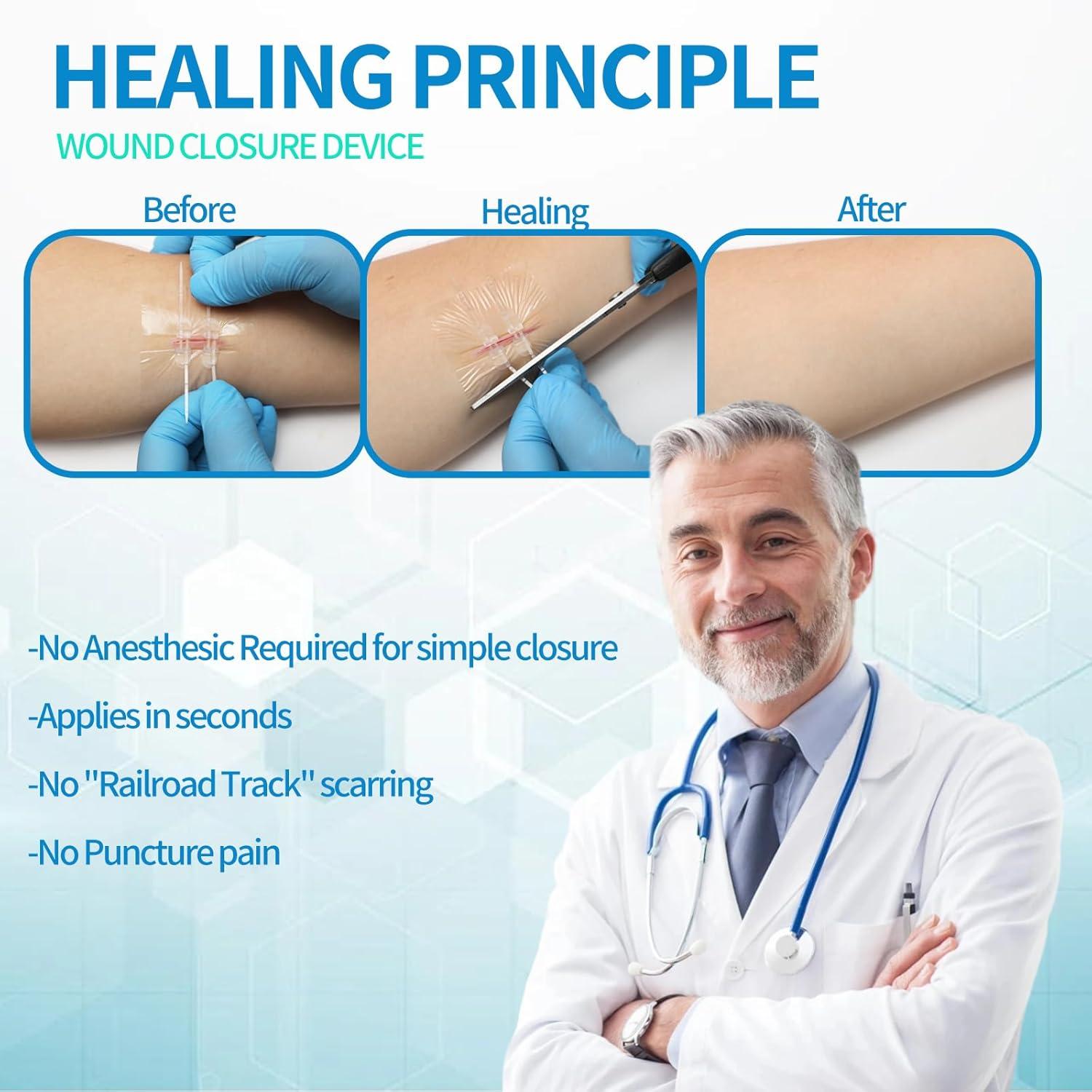 Emergency Laceration Closures - Zipstitch Wound Closure Device (4 Set ...