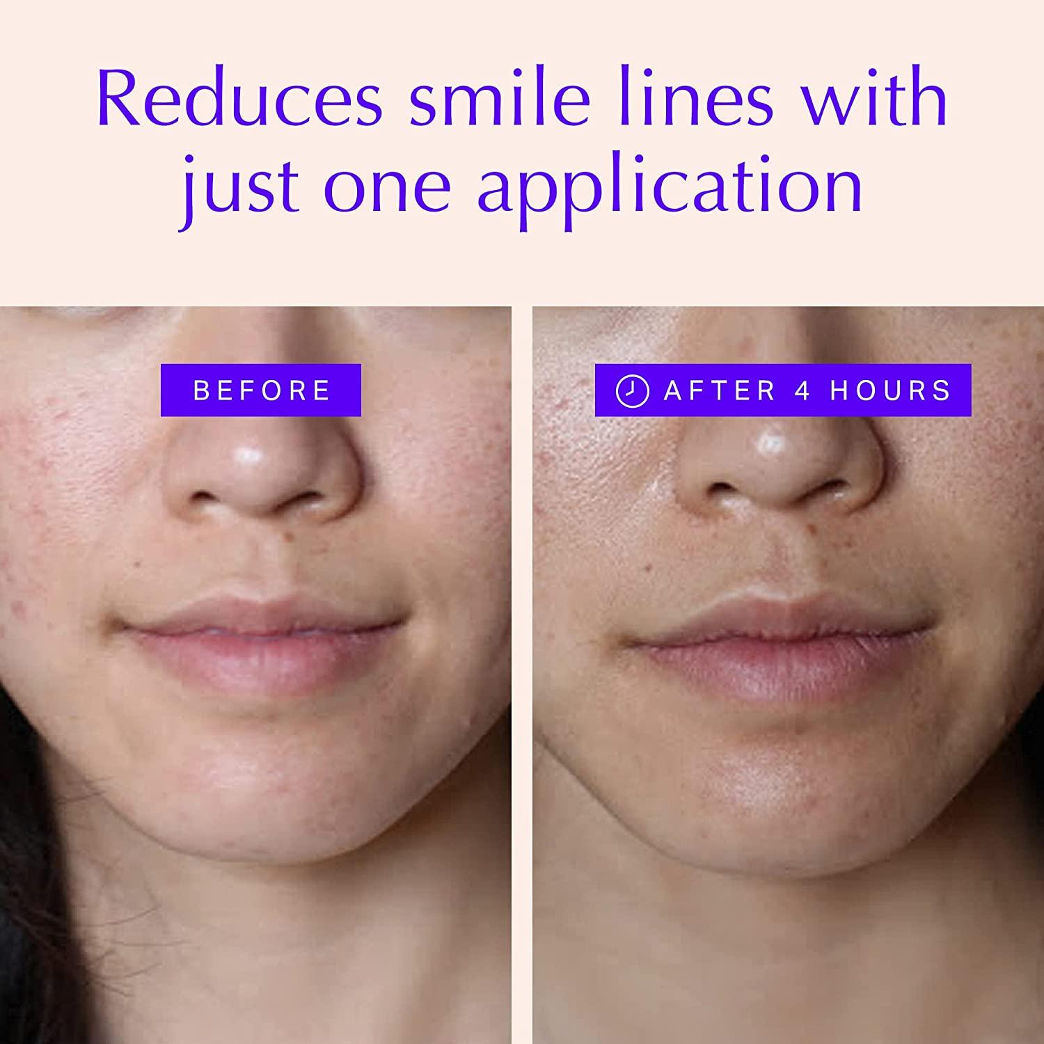 Smile Line Wrinkle Patches - Anti-Aging Solution for Fine Lines - Skin ...